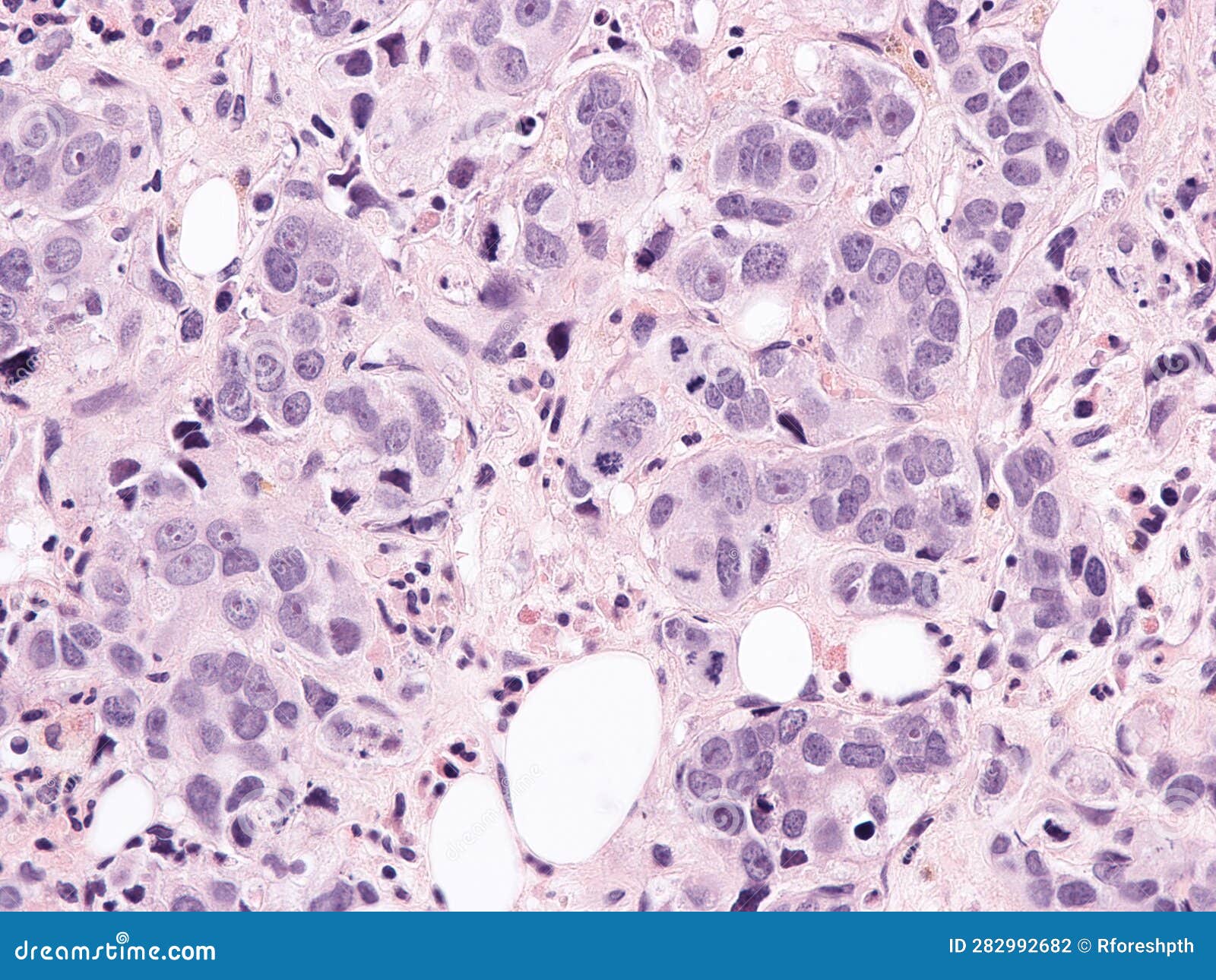 Tumor Cells Under A Microscope Tissues Affected By Cancer Cells Under A Microscope Nauka