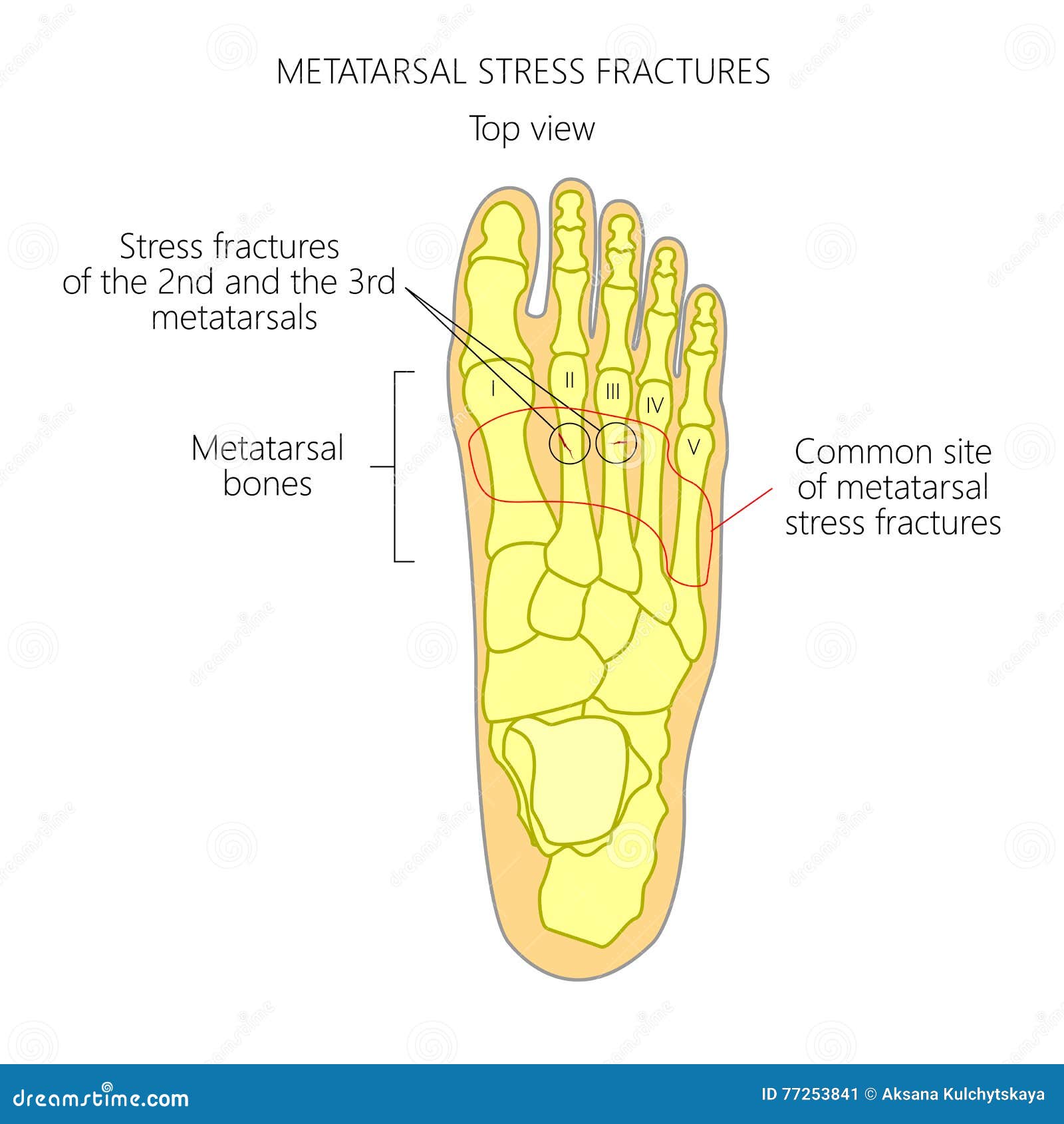 Metatarsalspänningsbrott vektor illustrationer. Illustration av skarv ...