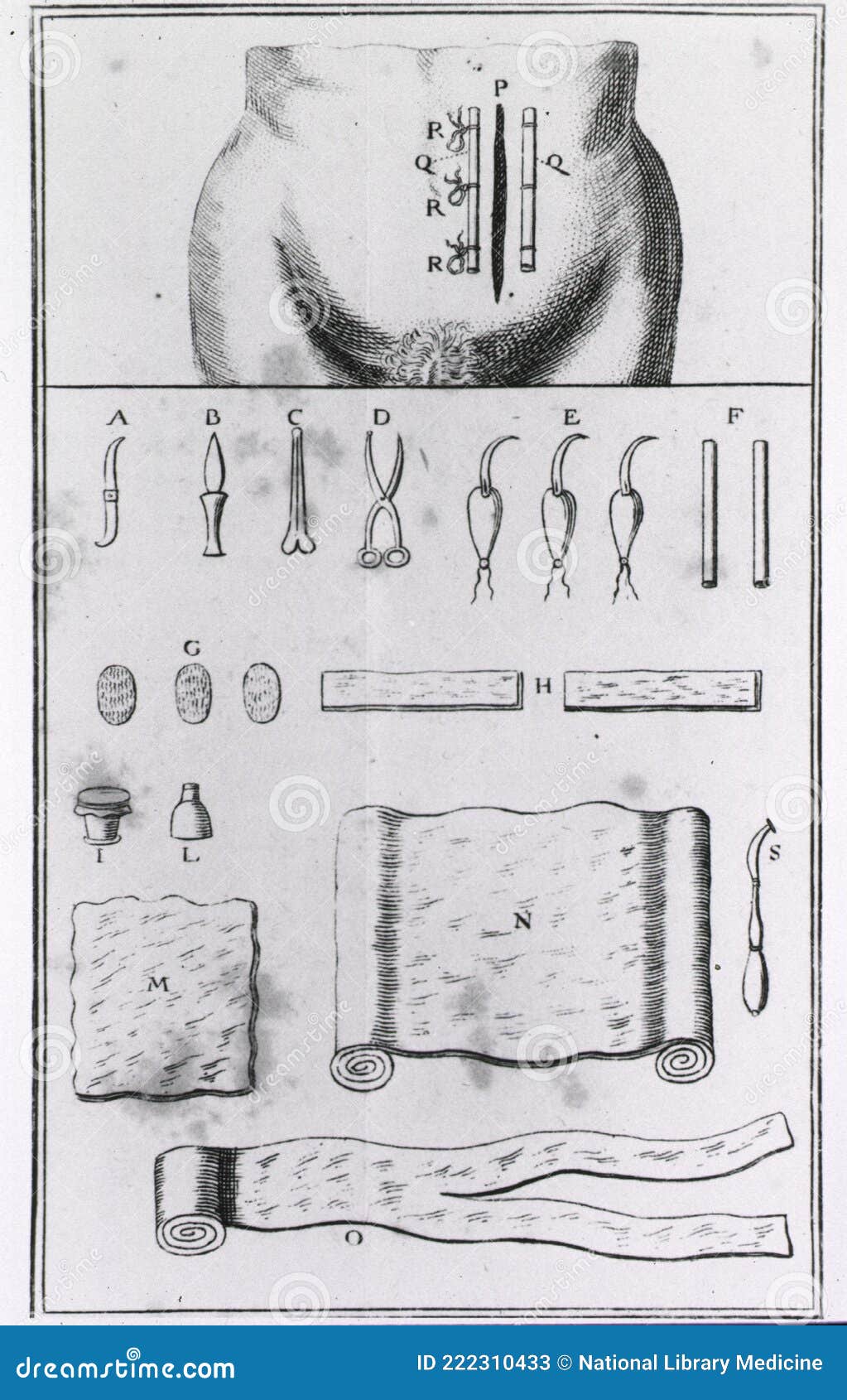 Method Of Closing Incision After A Cesarean Section Picture. Image ...