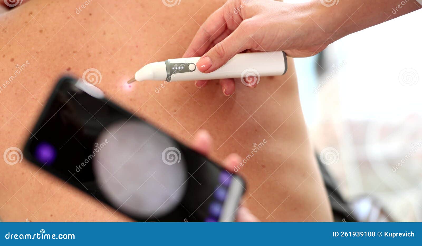 Method of Dermatoscopy of Skin Formations and Moles and Examination ...