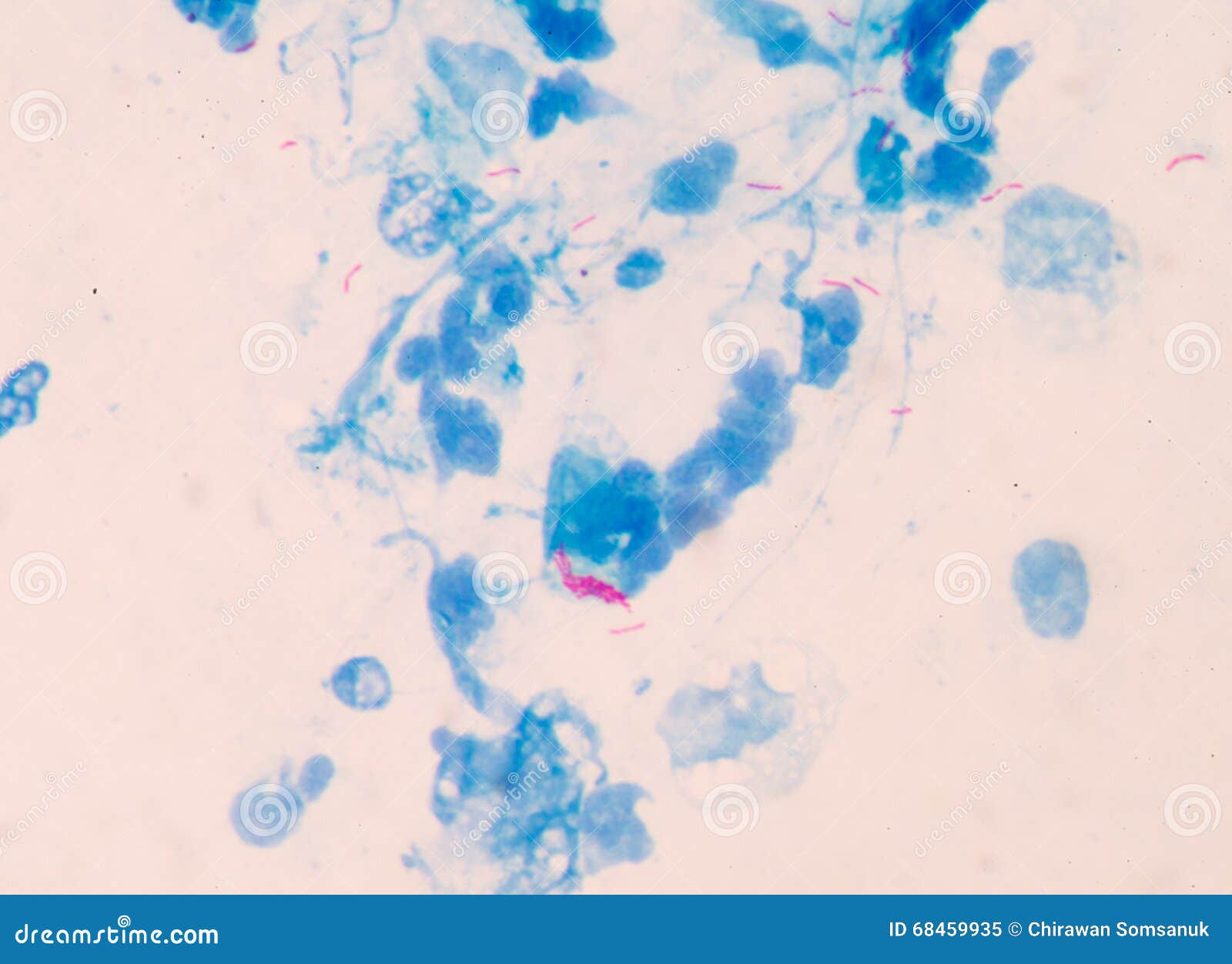 Micro Bacterium Tuberculosis. Stock Image - Image of organism, bacteria ...