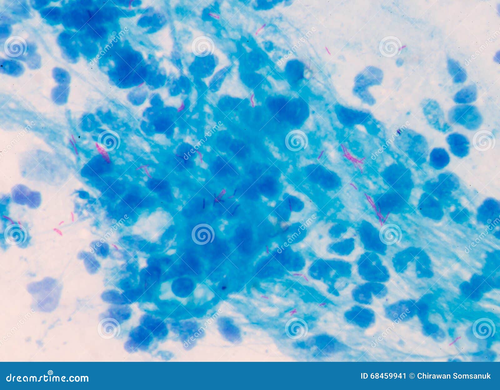 Micro Bacterium Tuberculosis. Stock Image - Image of life, organism ...