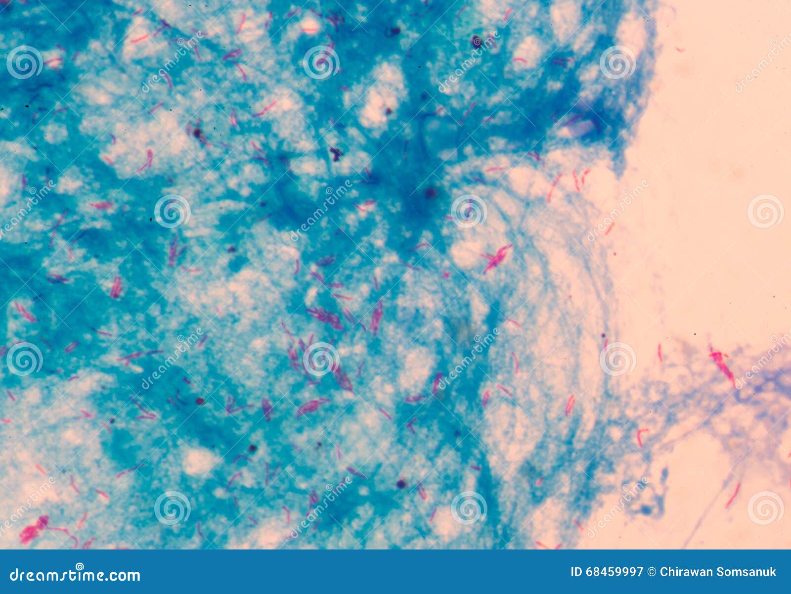 Micro Bacterium Tuberculosis. Stock Image - Image of meningitis, motion ...