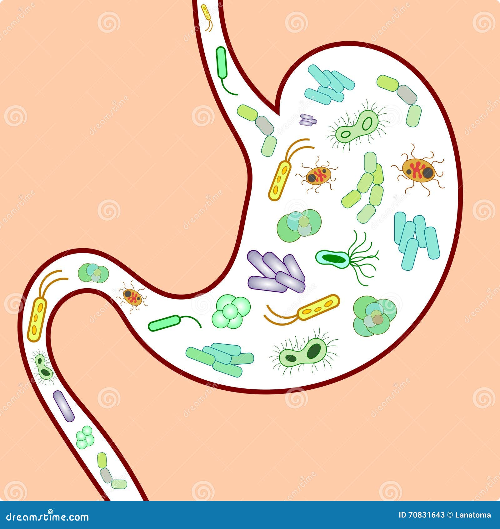 Stomach With Bacterial Gastroenteritis Vector Illustration ...
