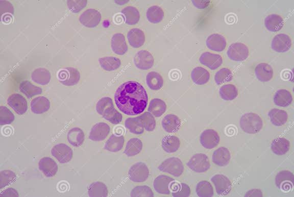 Microcitosis imagen de archivo. Imagen de hospital, medicina - 50487965