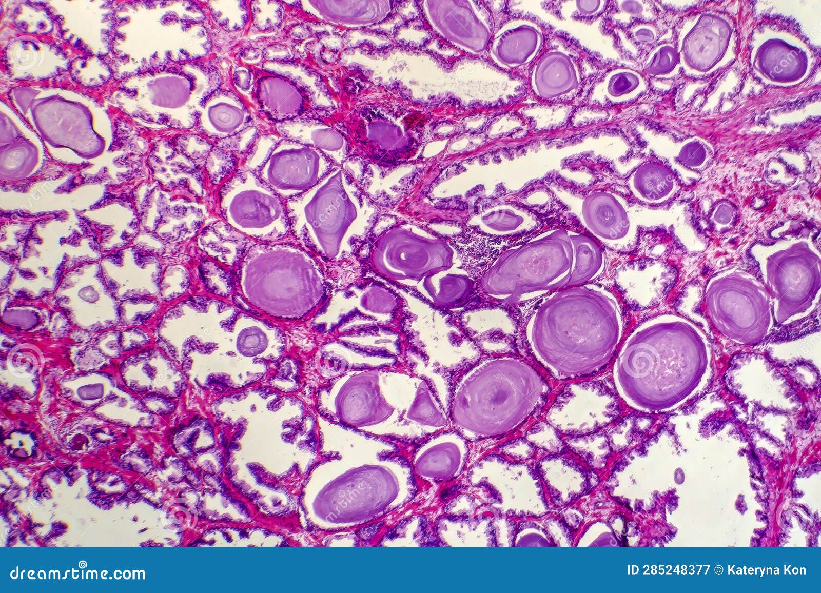 Micrograph of Prostatic Hyperplasia Stock Image - Image of microscopic ...