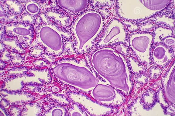 Micrograph of Prostatic Hyperplasia Stock Photo - Image of benign ...