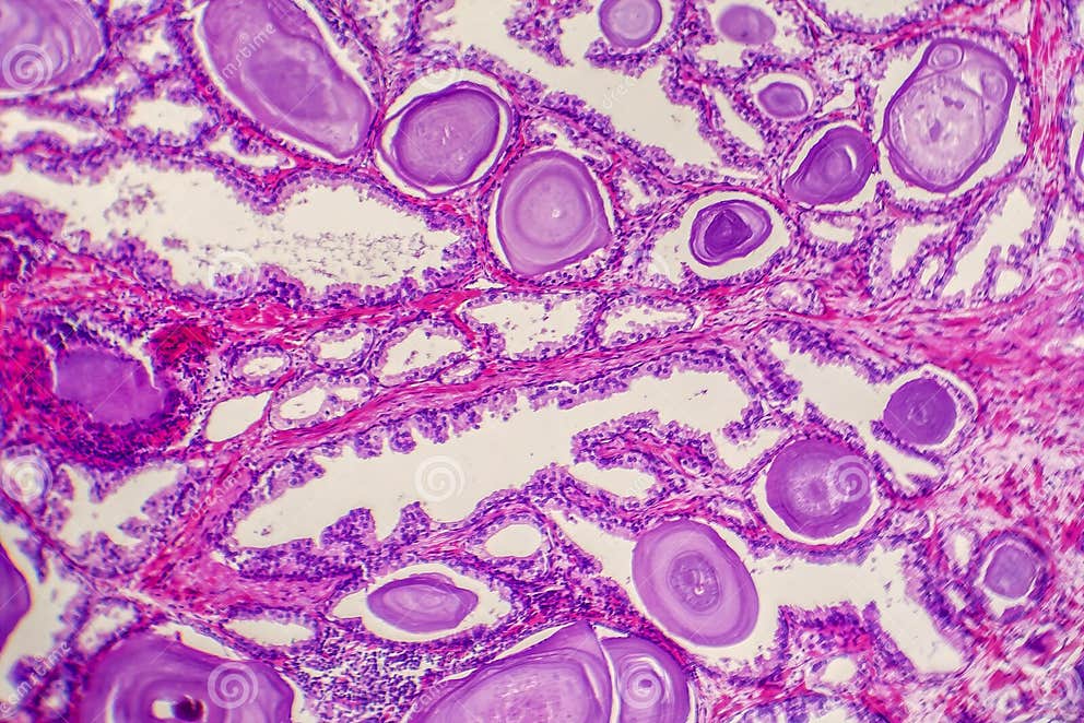 Micrograph of Prostatic Hyperplasia Stock Image - Image of hyperplasia ...