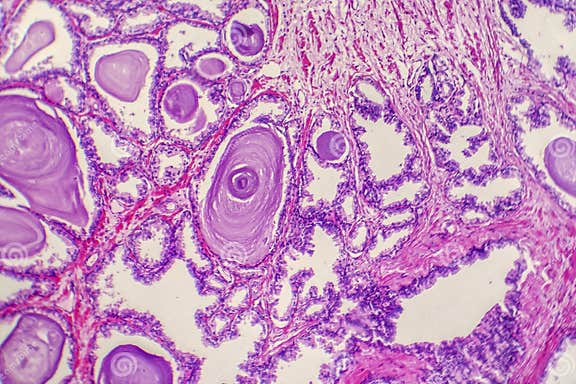 Micrograph of Prostatic Hyperplasia Stock Image - Image of gland ...