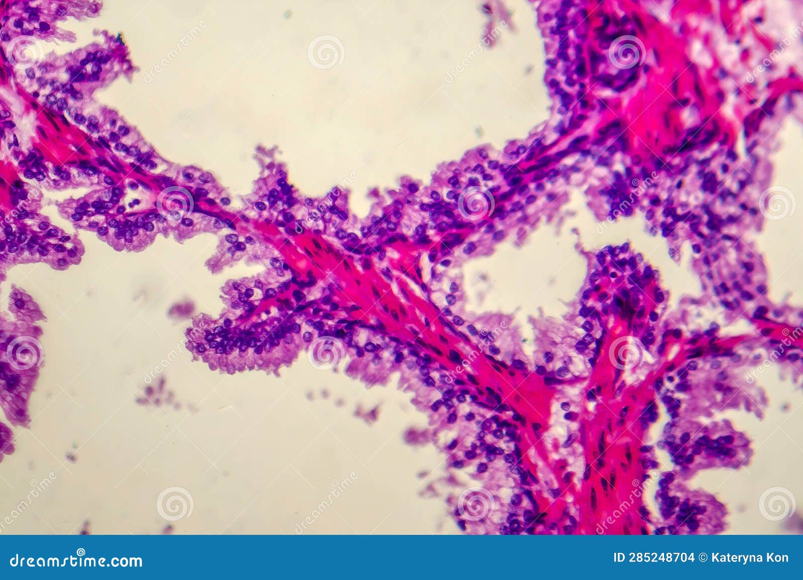 Micrograph of Prostatic Hyperplasia Stock Photo - Image of research ...