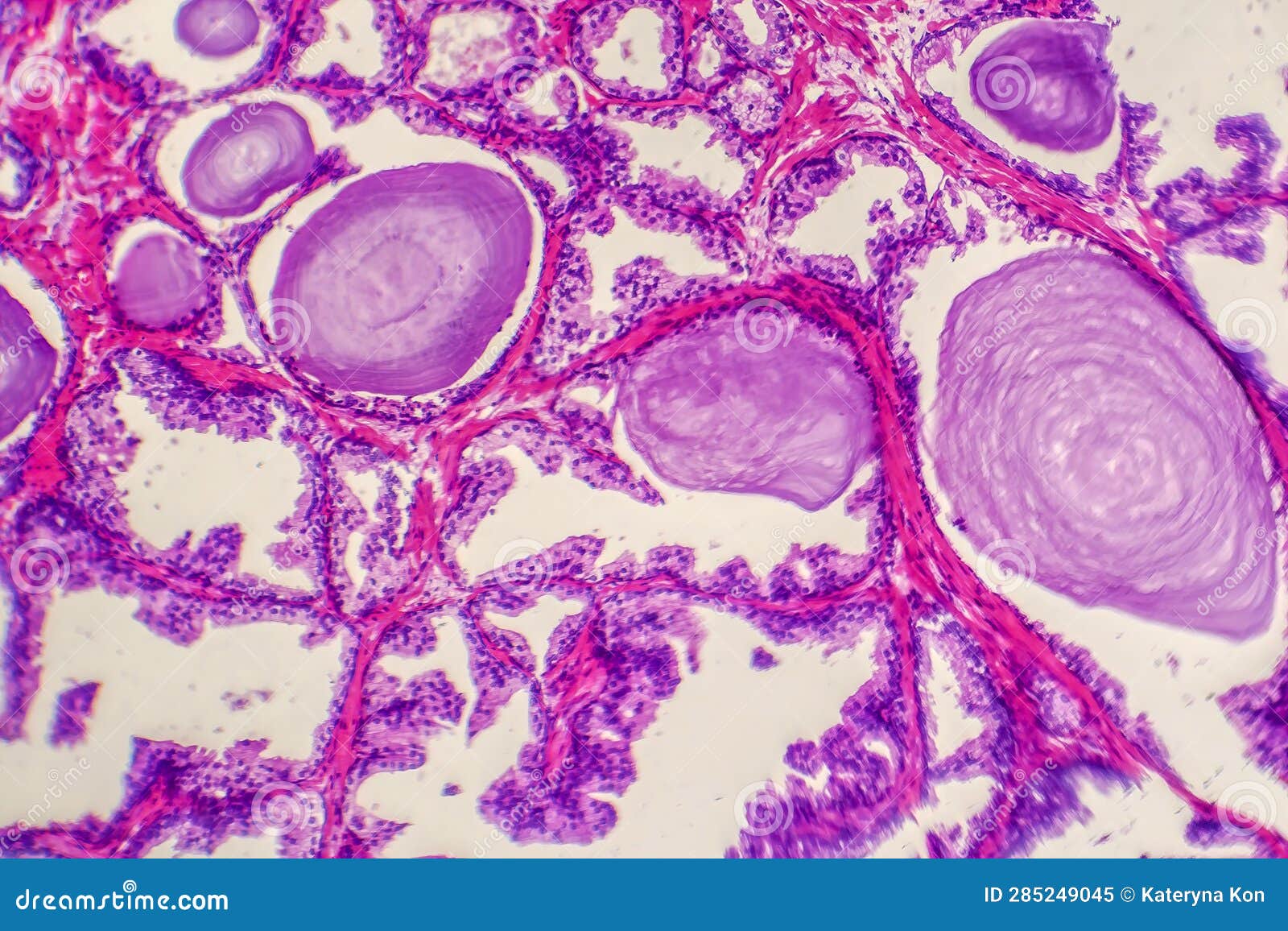 Micrograph of Prostatic Hyperplasia Stock Image - Image of examination ...