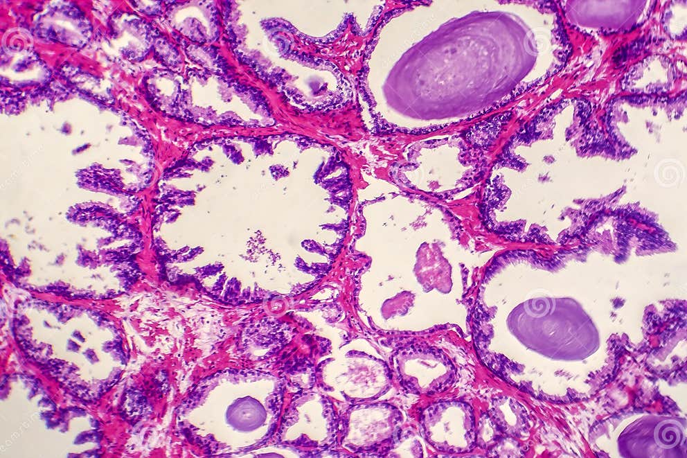Micrograph of Prostatic Hyperplasia Stock Photo - Image of cells ...