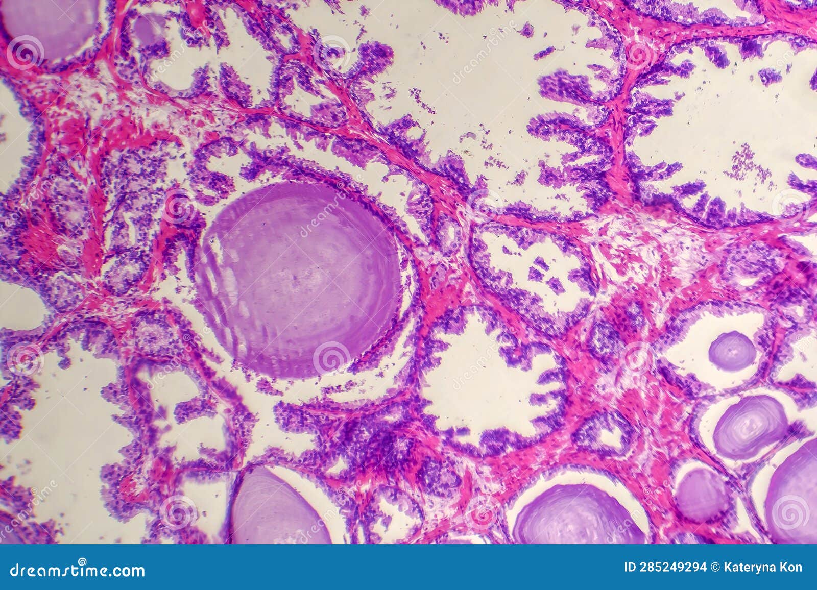Micrograph of Prostatic Hyperplasia Stock Photo - Image of health, care ...