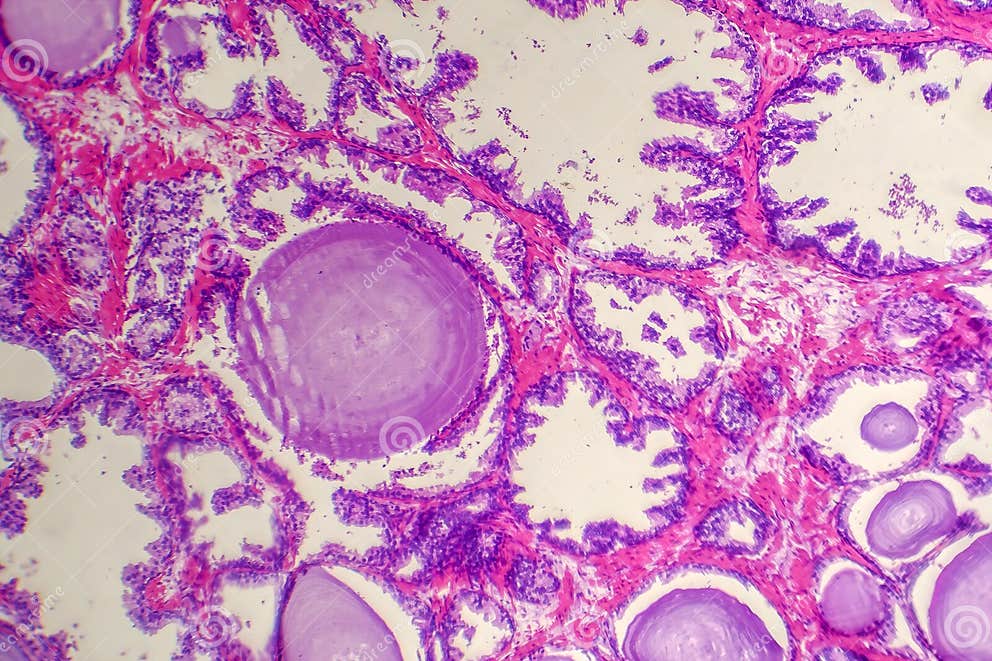Micrograph of Prostatic Hyperplasia Stock Photo - Image of health, care ...