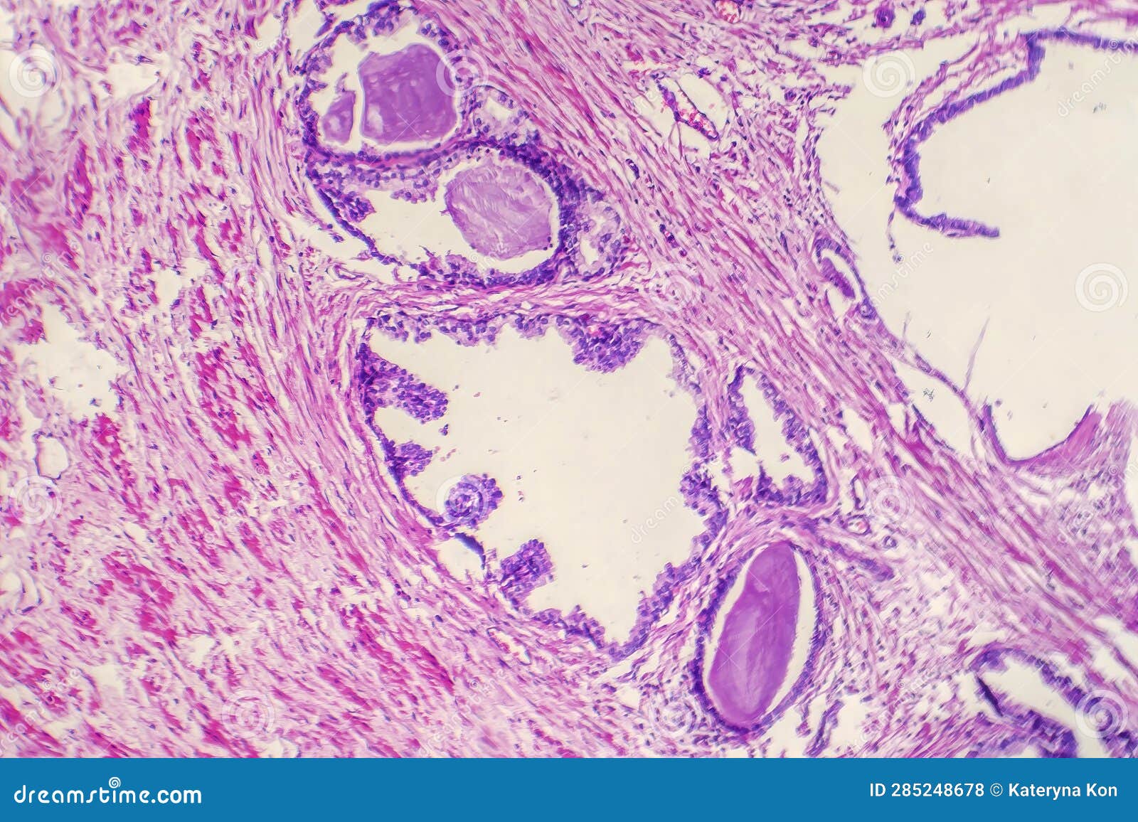 Micrographe De L'hyperplasie Prostatique Illustration Stock ...