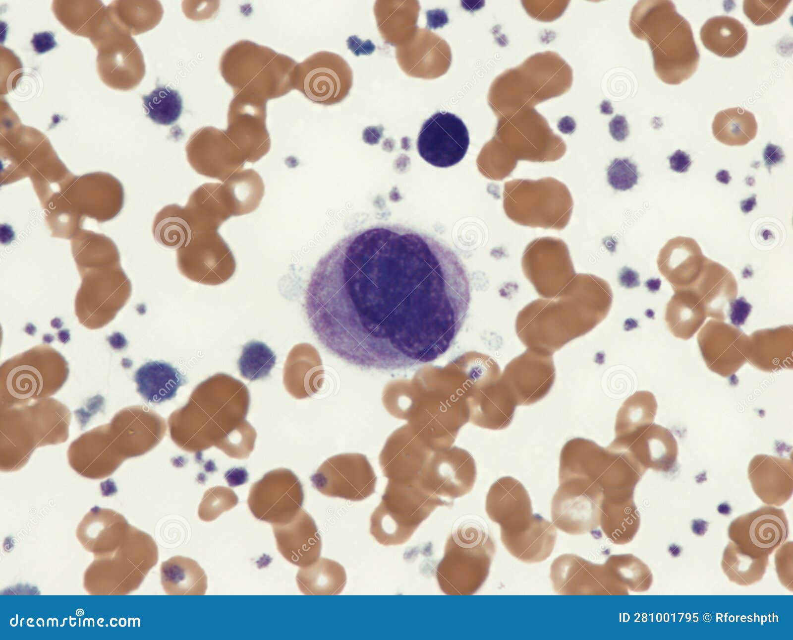 Micromegakaryocyte in Peripheral Blood. Stock Image - Image of bone ...