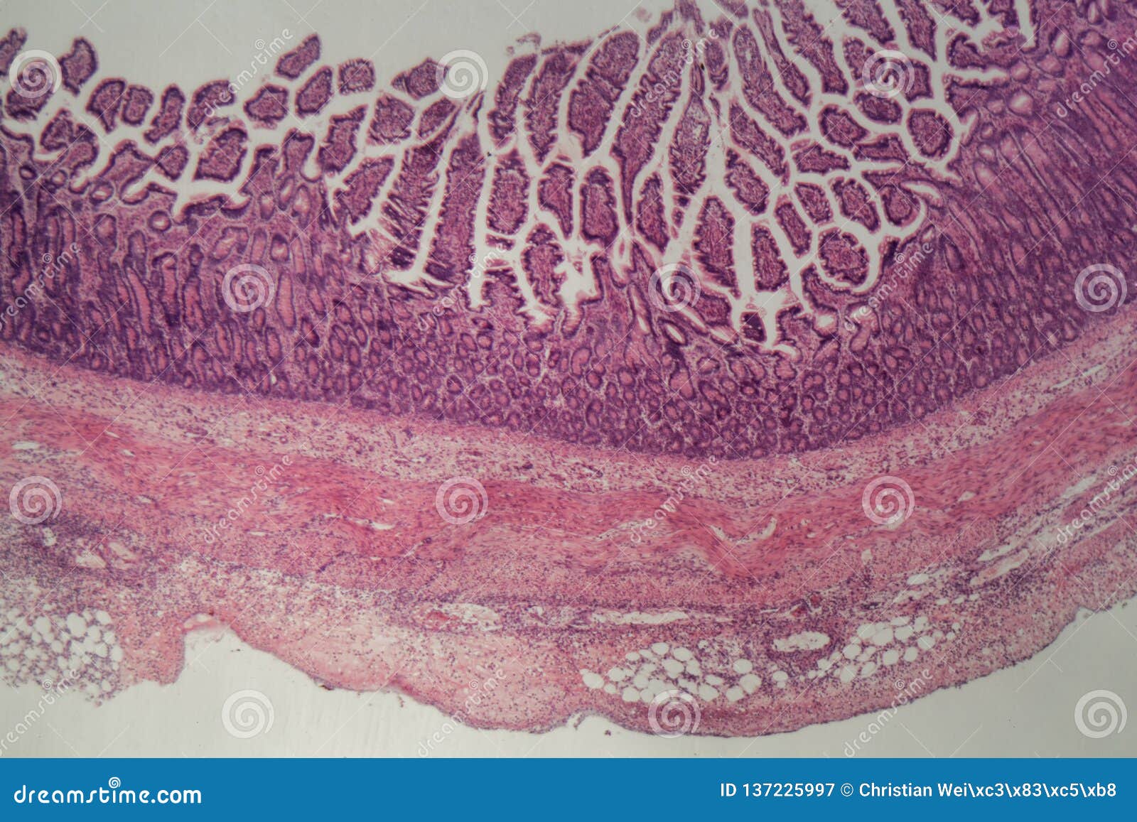 Microscope Photo of a Large Intestine Section with Inflammation Colitis ...