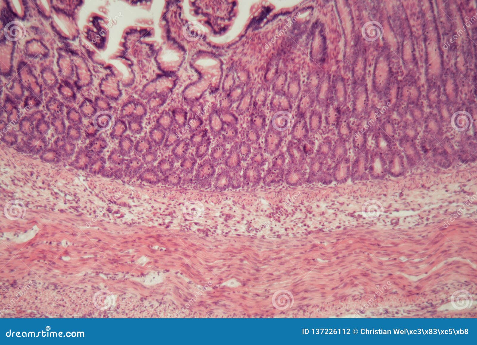 Microscope Photo of a Large Intestine Section with Inflammation Colitis ...