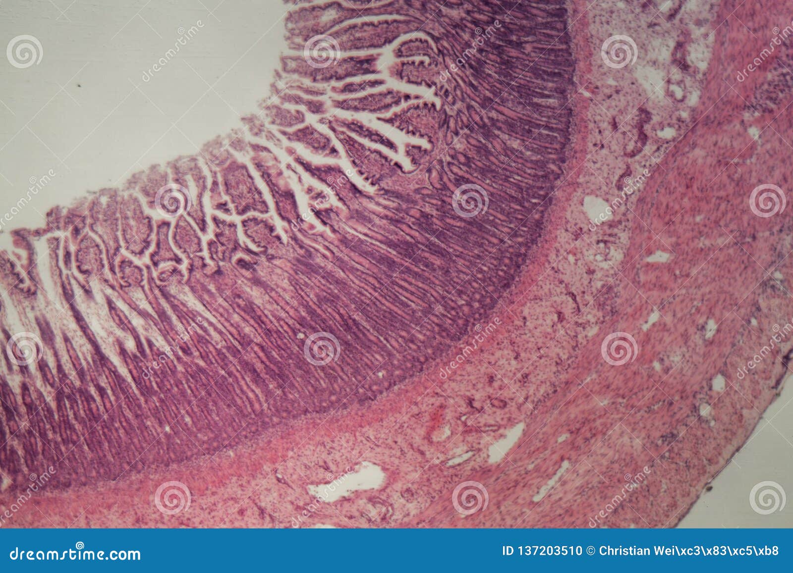 Microscope Photo of a Large Intestine Section with Inflammation Colitis ...