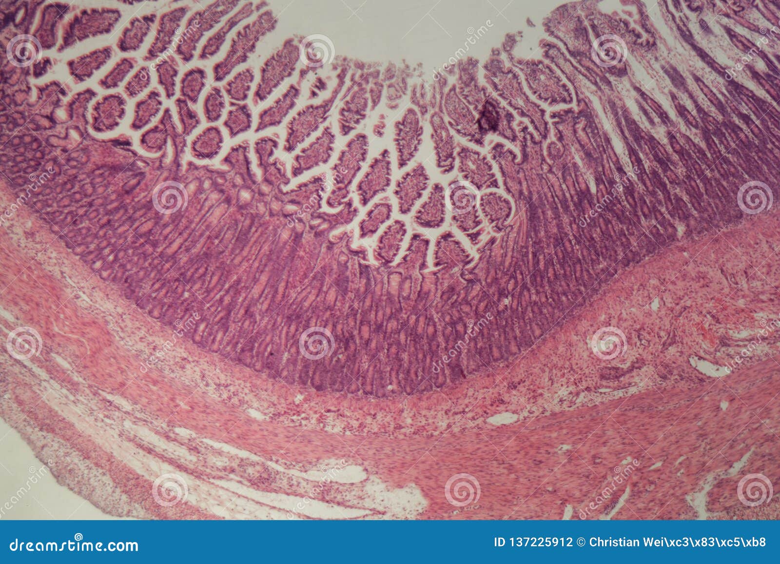 Microscope Photo of a Large Intestine Section with Inflammation Colitis ...