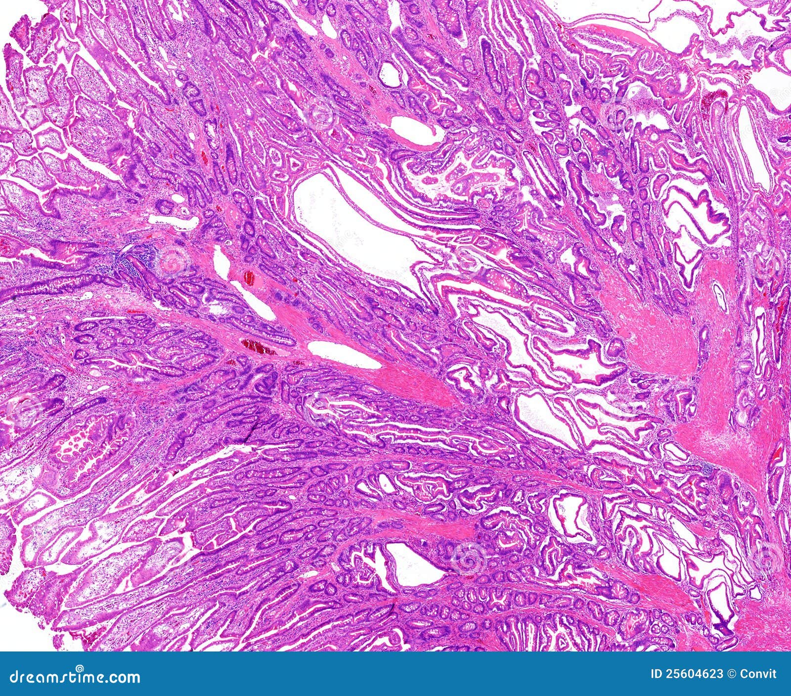 Microscope Picture of Intestinal Polyp Stock Image - Image of growth ...