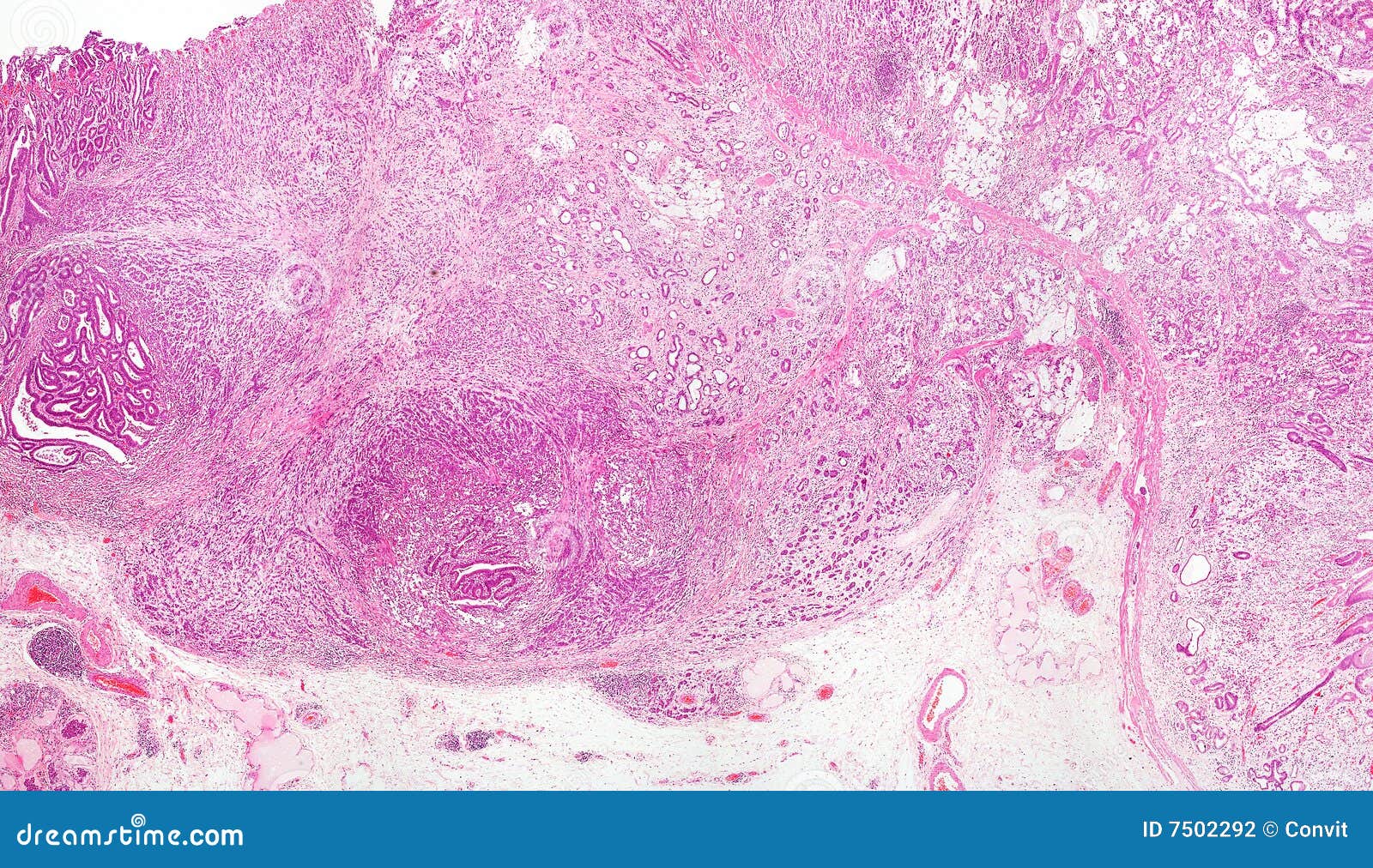 Microscopia Del Cáncer De Estómago Foto de archivo - Imagen de ...