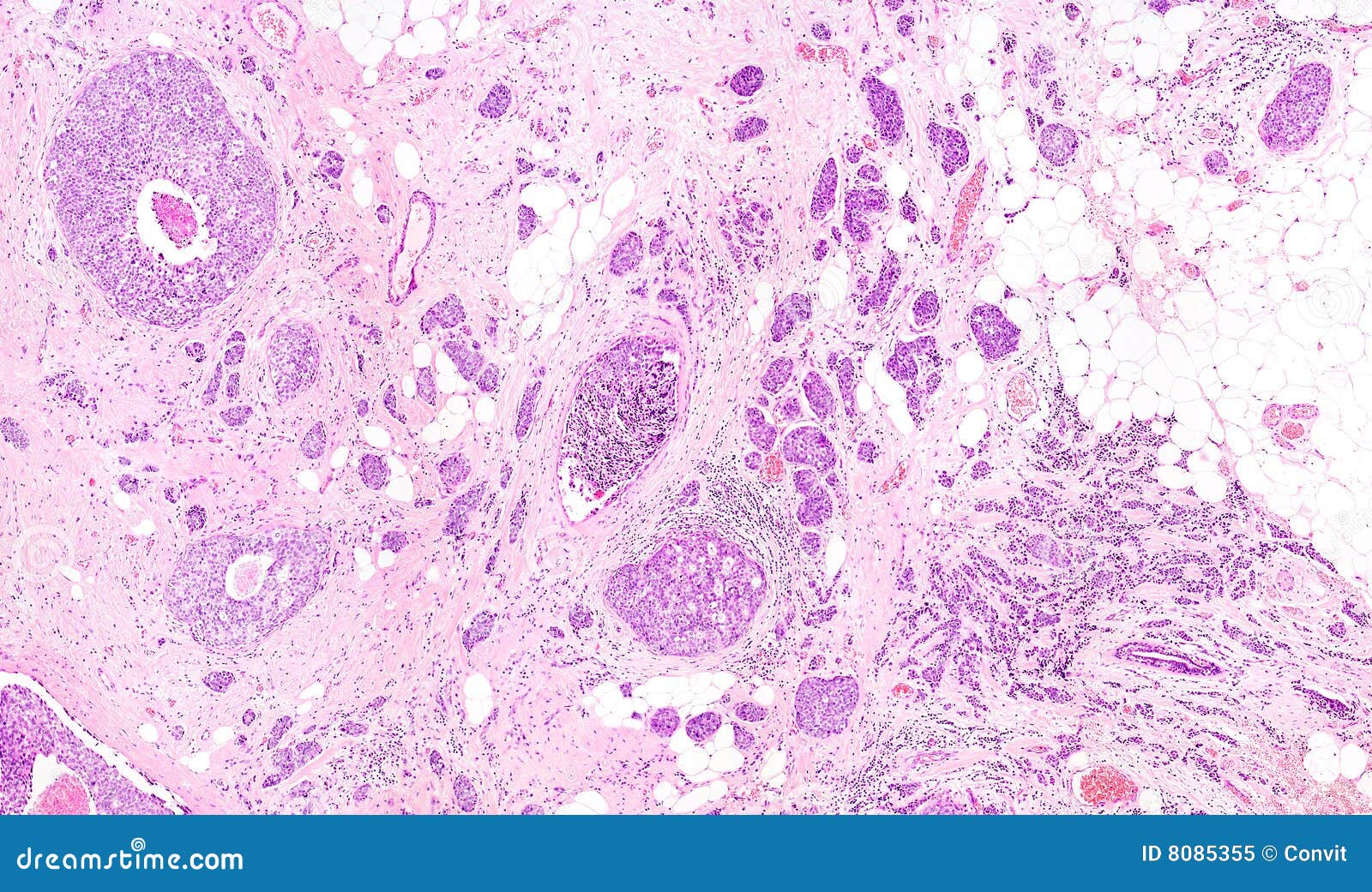 Microscopia Del Cáncer De Pecho Imagen de archivo - Imagen de ciencia ...