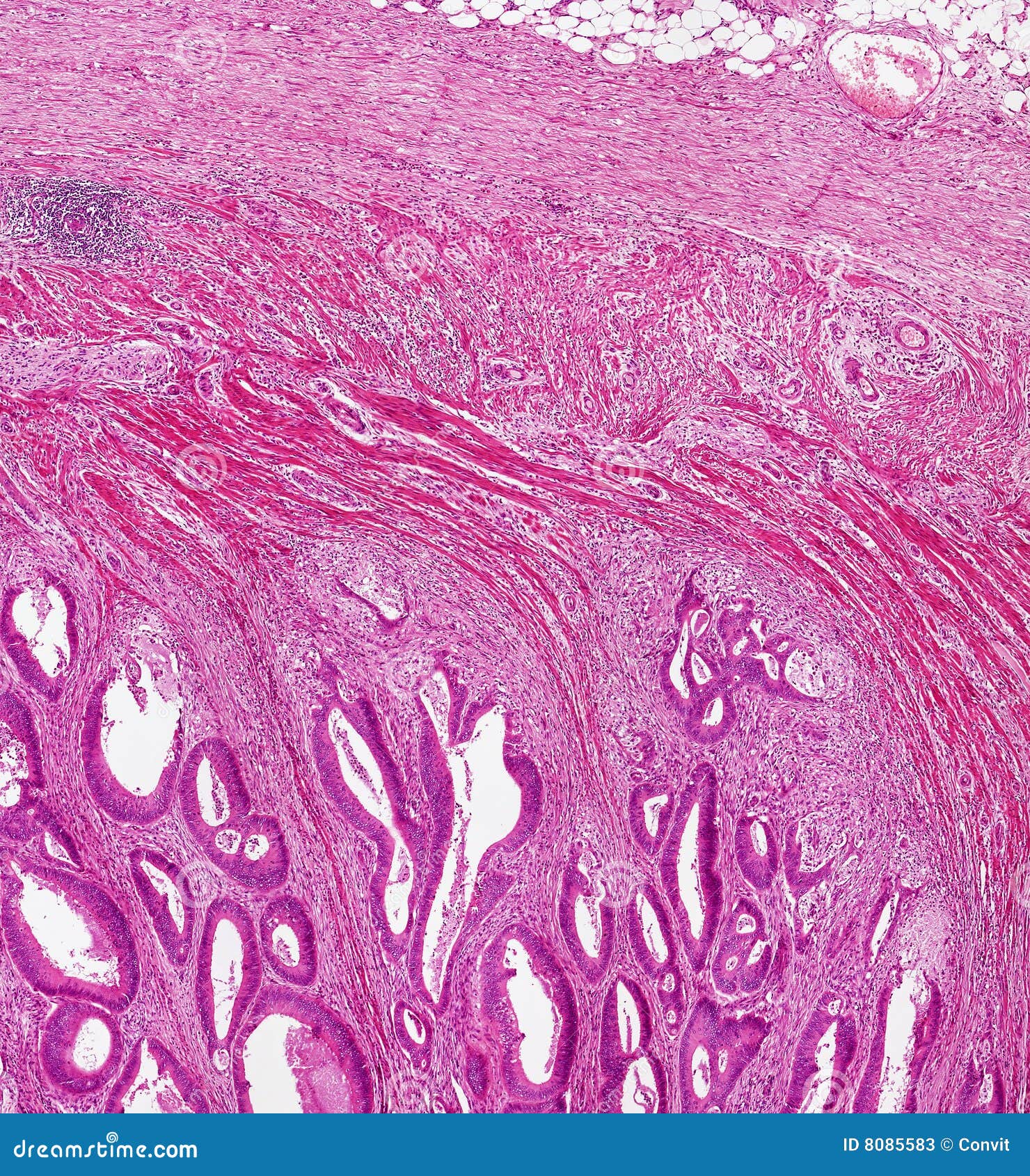 Microscopia Del Cáncer Del Intestino Imagen de archivo - Imagen de ...