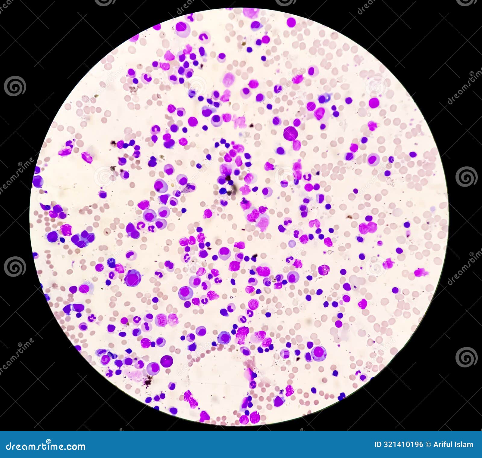 Microscopic Image of Blood Cancer Bone Marrow Study Stock Photo - Image ...