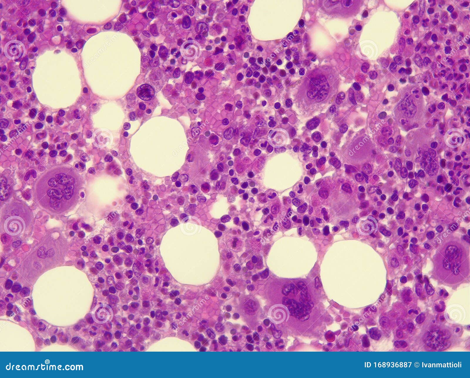 Bone Marrow Examination Procedure: Biopsy, Aspiration Or Paracentesis ...