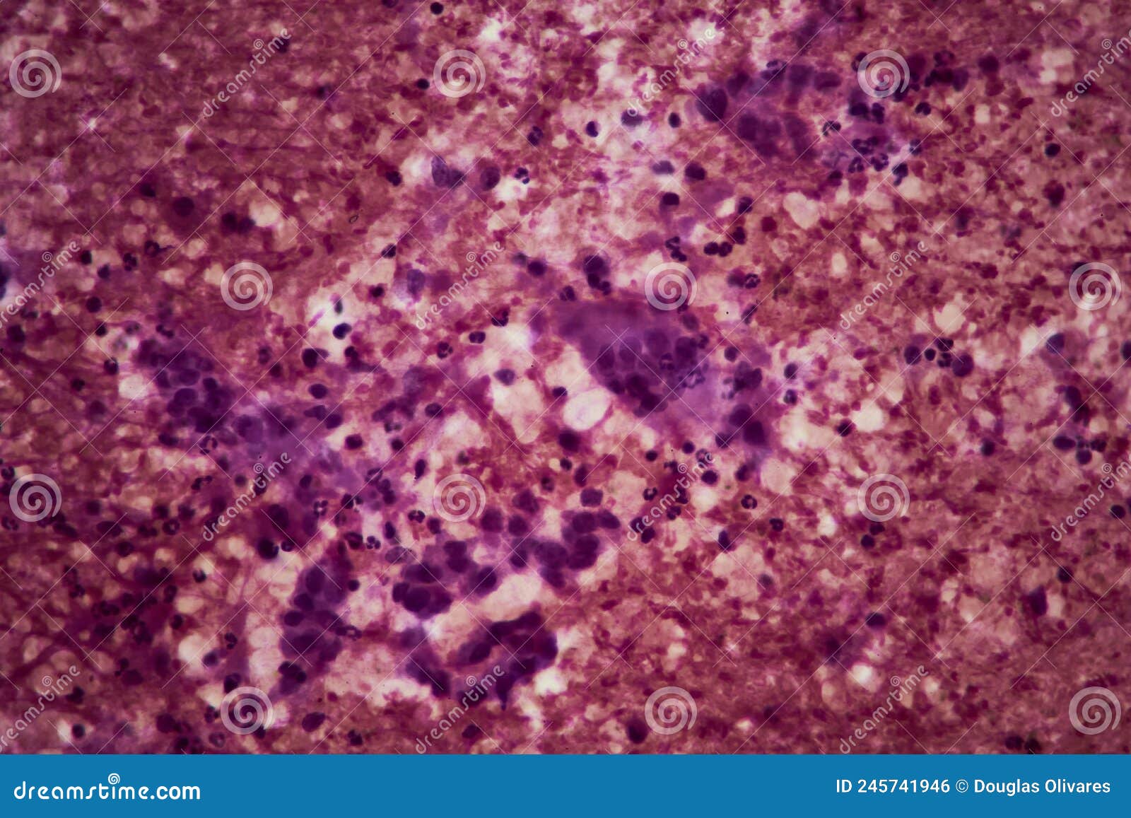 107 Pancreatic Cancer Histology Stock Photos - Free & Royalty-Free ...