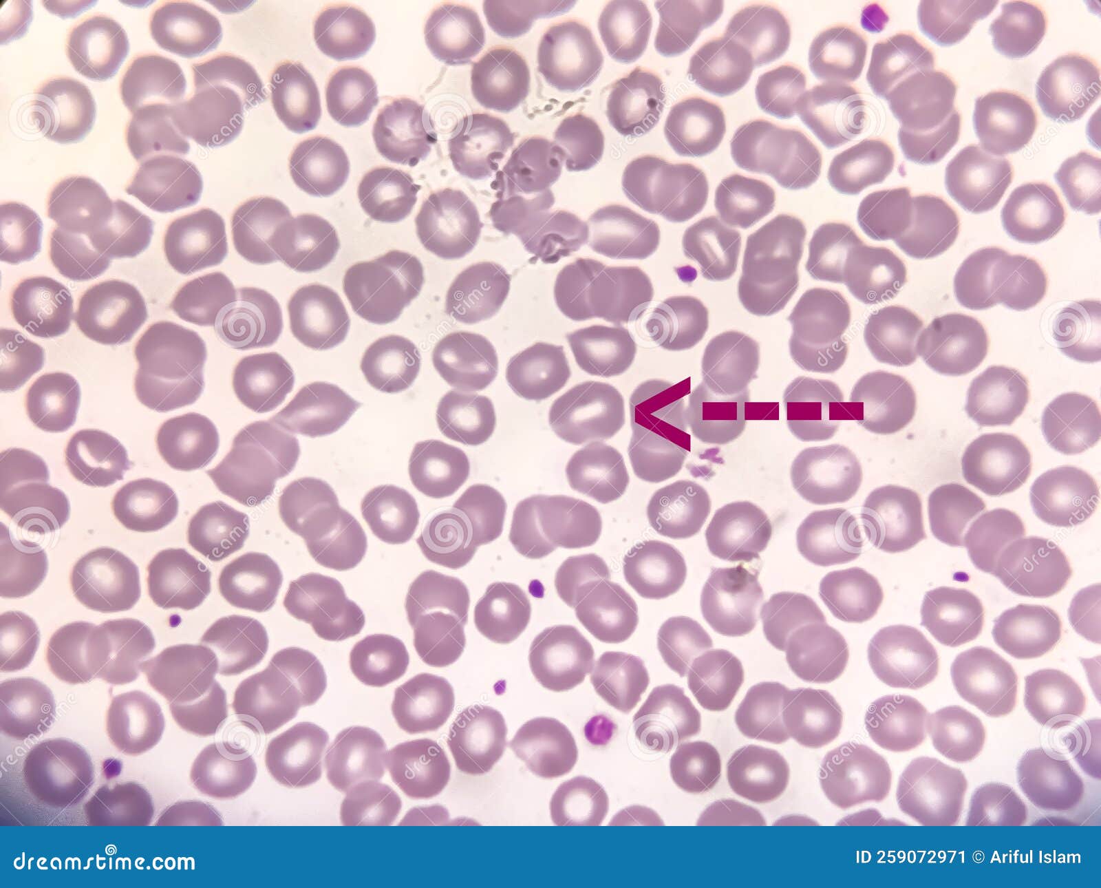 Hematological Slide Under Microscopy Showing Essential Thrombocytosis ...