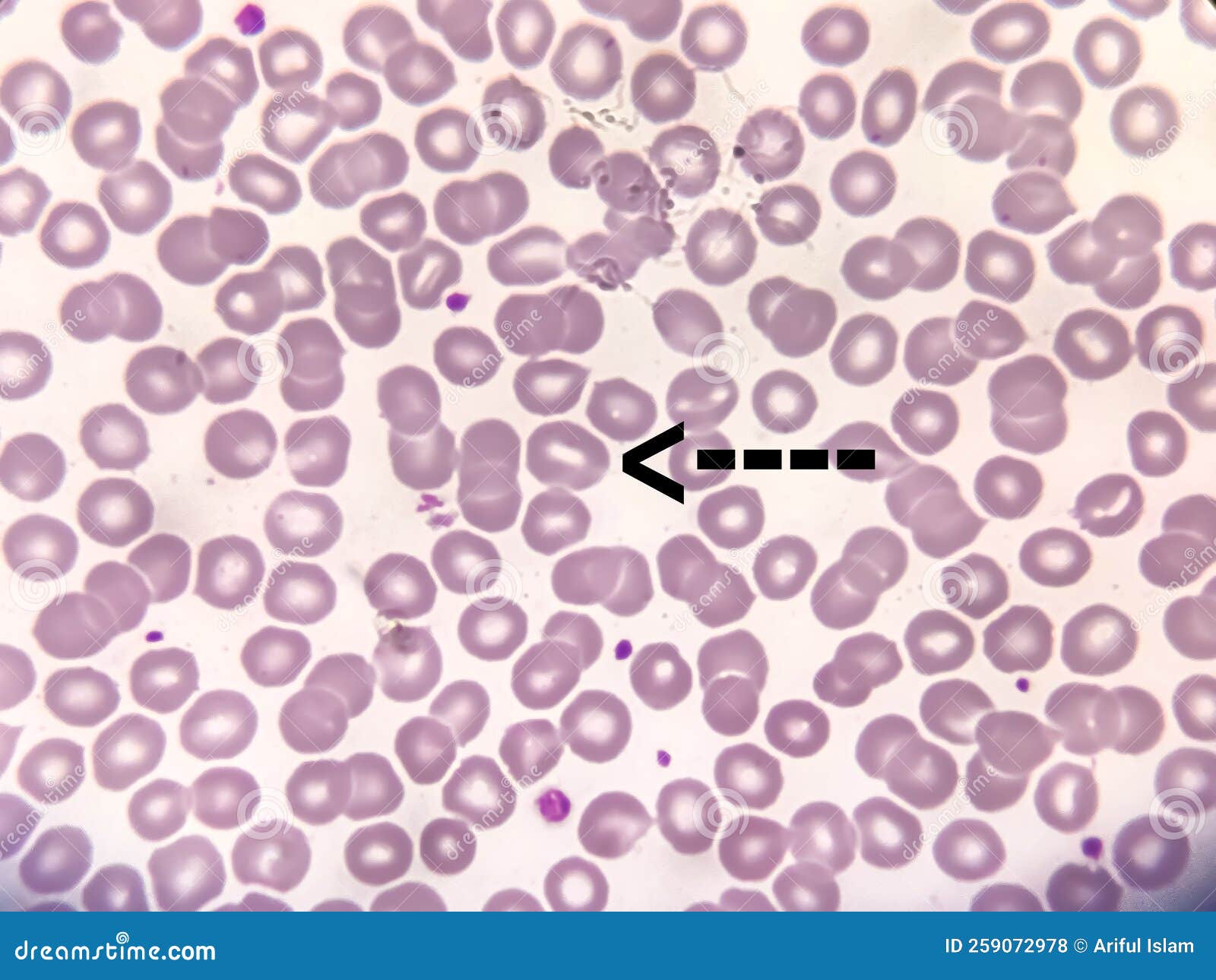 Microscopic View of Hematological Stained Slide Leucopenia Stock Photo ...