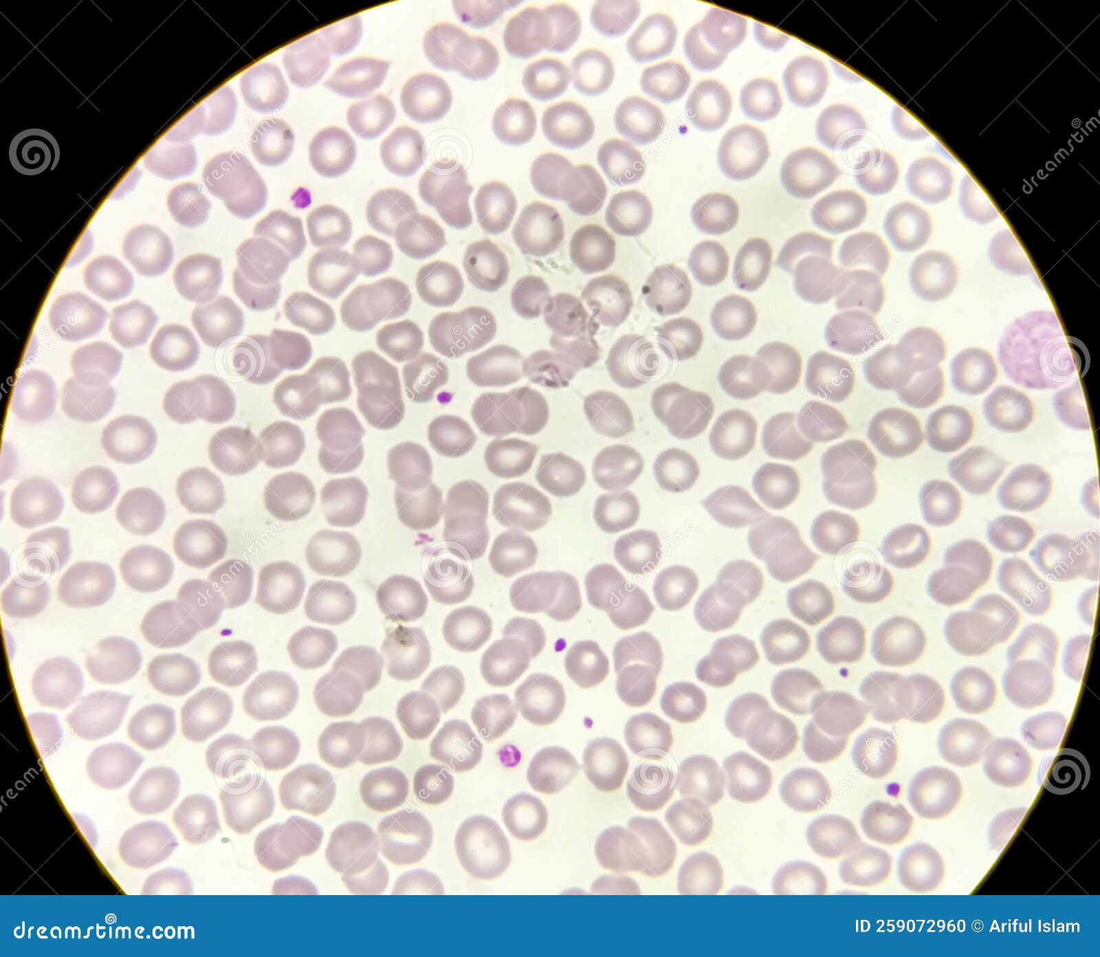 Hematological Slide Under Microscopy Showing Essential Thrombocytosis ...