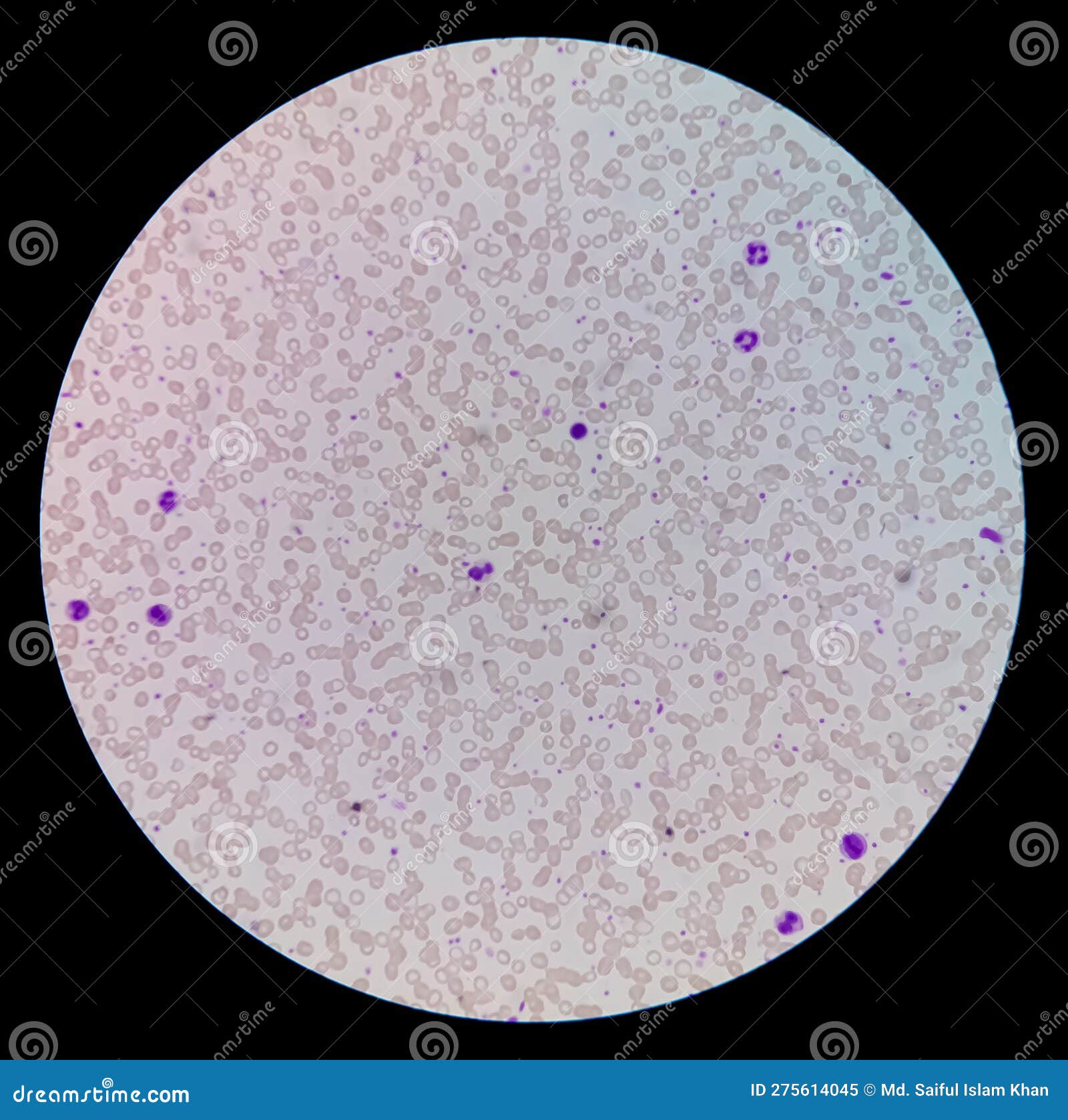 Microscopic View of Hematology Stained Slide in Laboratory. Stock Image ...