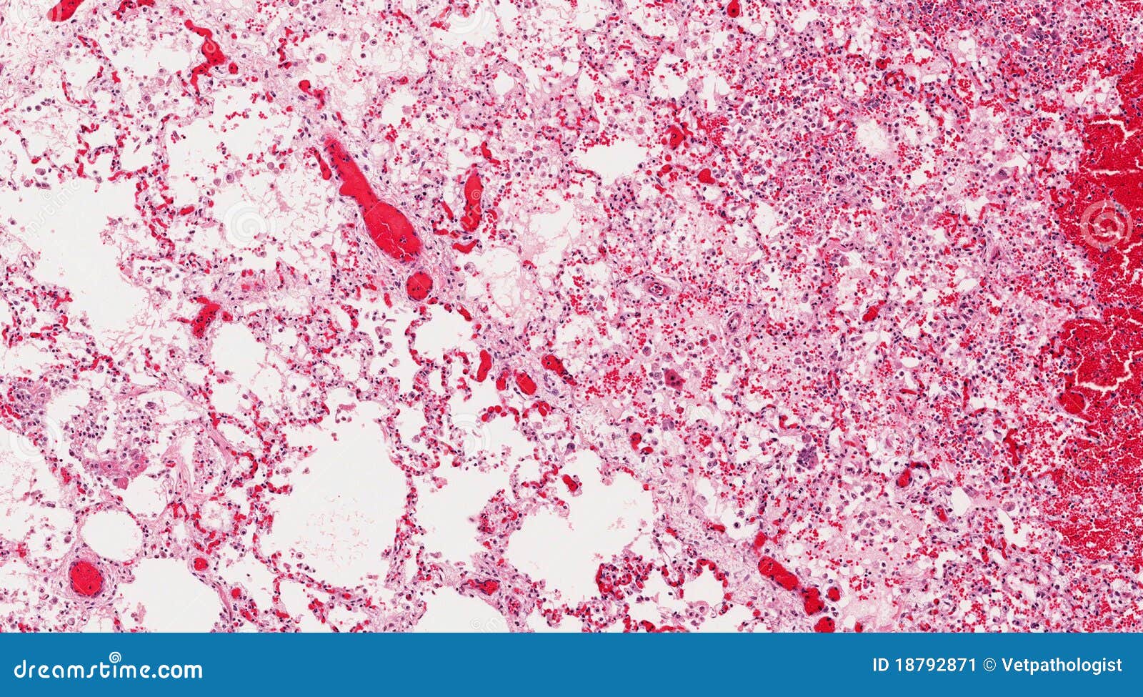 Microscopic View of Lung with Pneumonia Stock Image - Image of cough ...