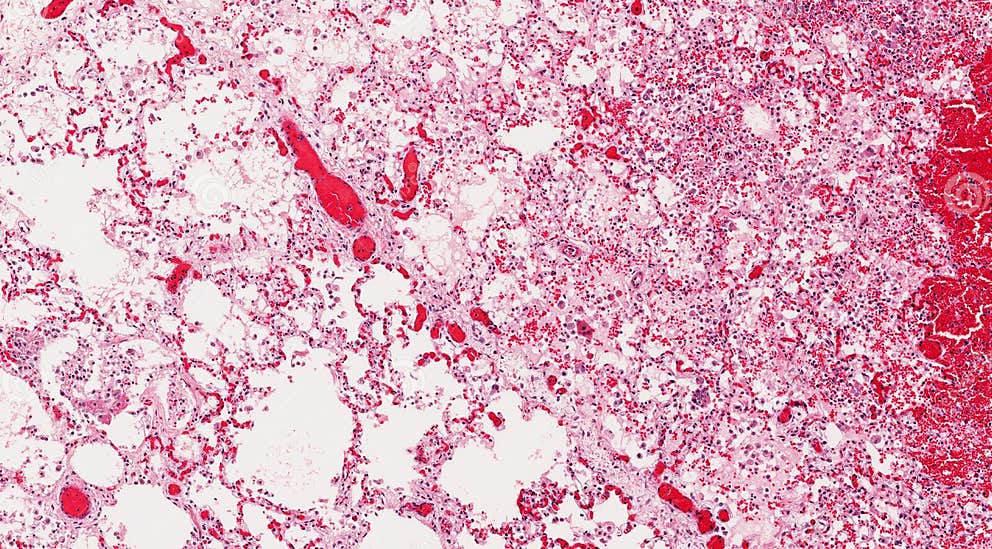 Microscopic View of Lung with Pneumonia Stock Image - Image of cough ...