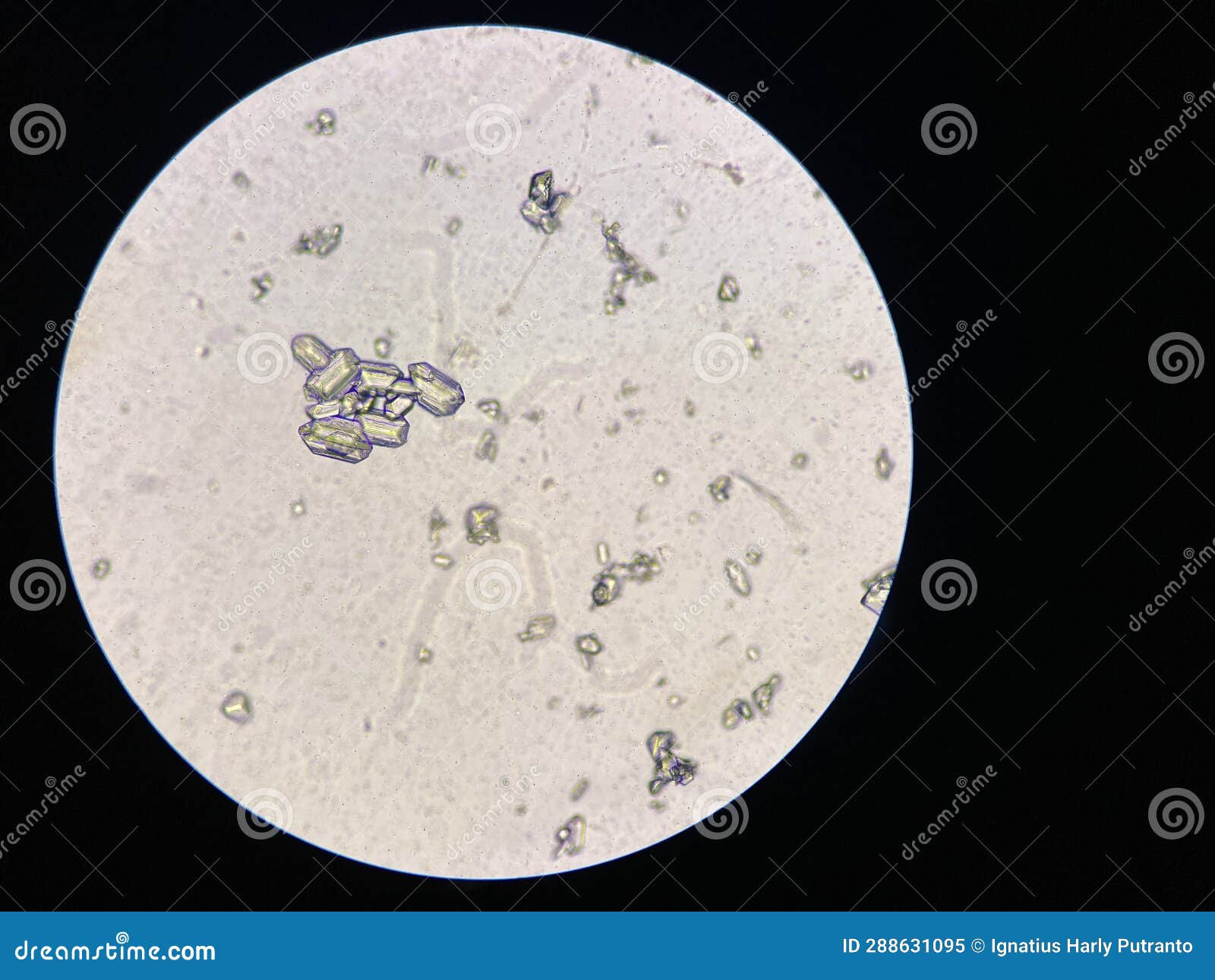 Microscopic View of Struvite Crystals from Urinary Sediment. Magnesium ...