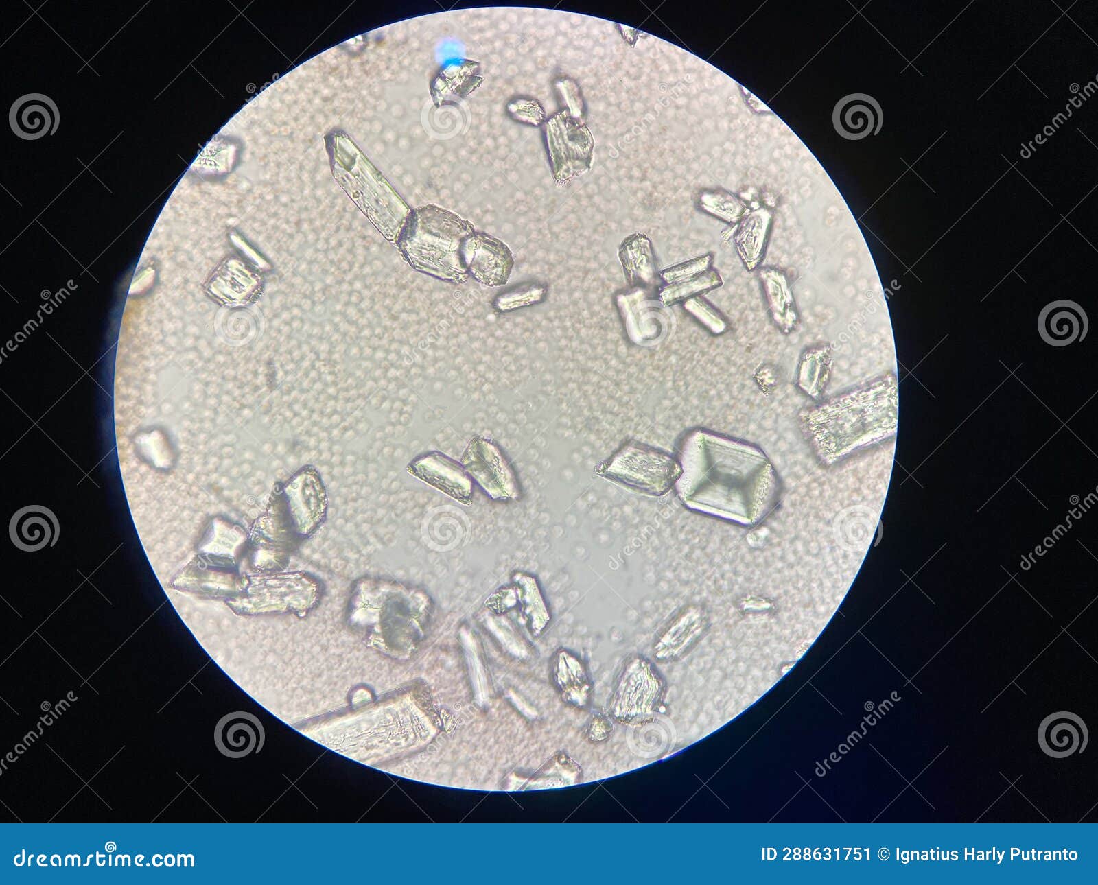 Microscopic View of Struvite Crystals from Urinary Sediment. Magnesium ...