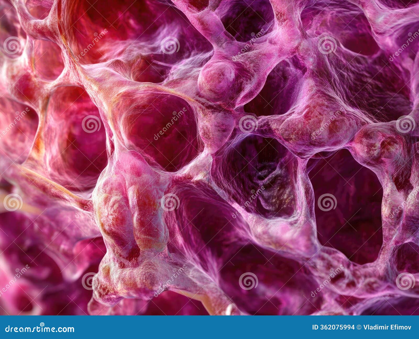 Microscopic View of Tumor Cells Stock Photo - Image of vessels, cancer ...