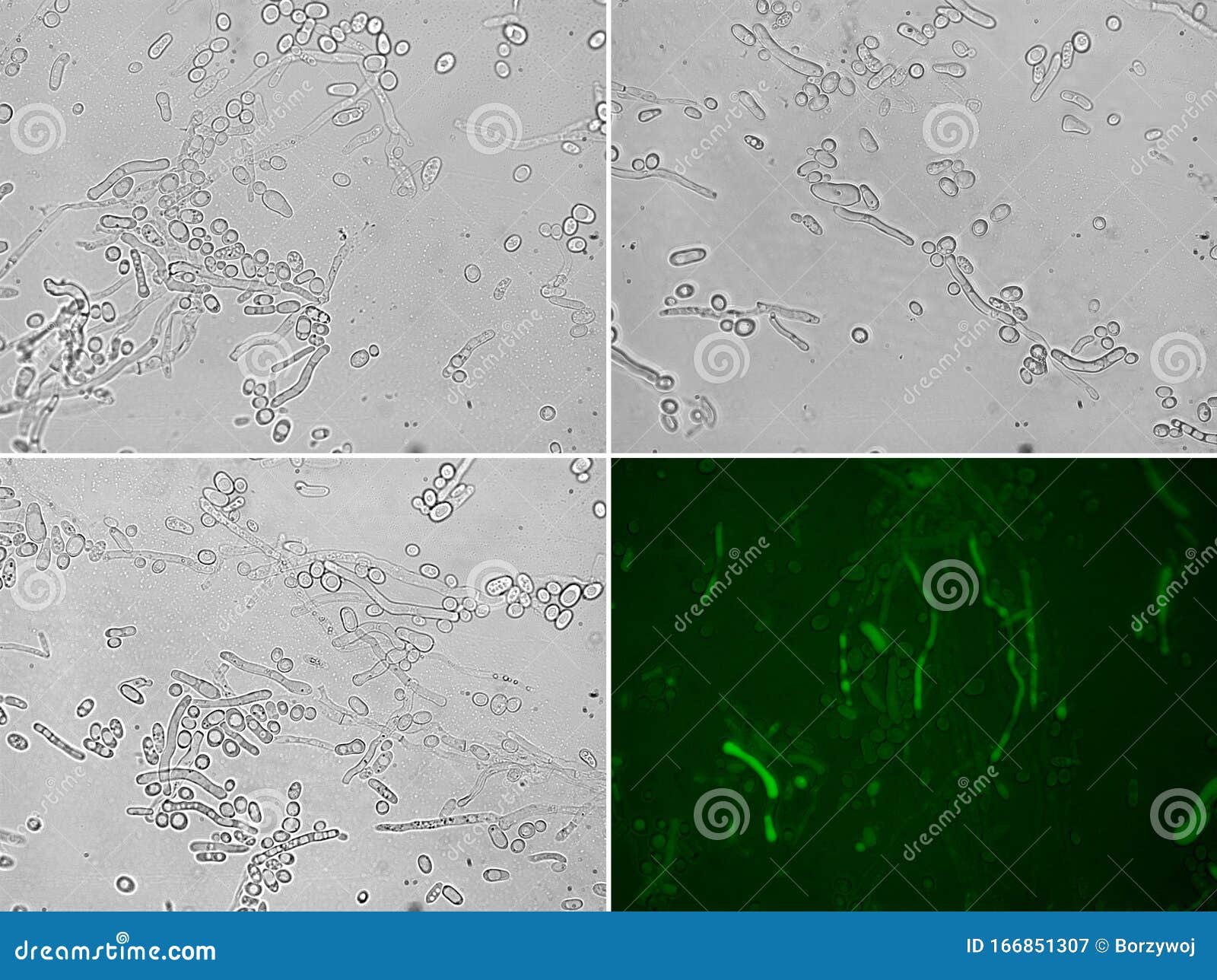 Microscopic Views Of A Thin Blood Smear From Malaria Infected Pa Stock ...