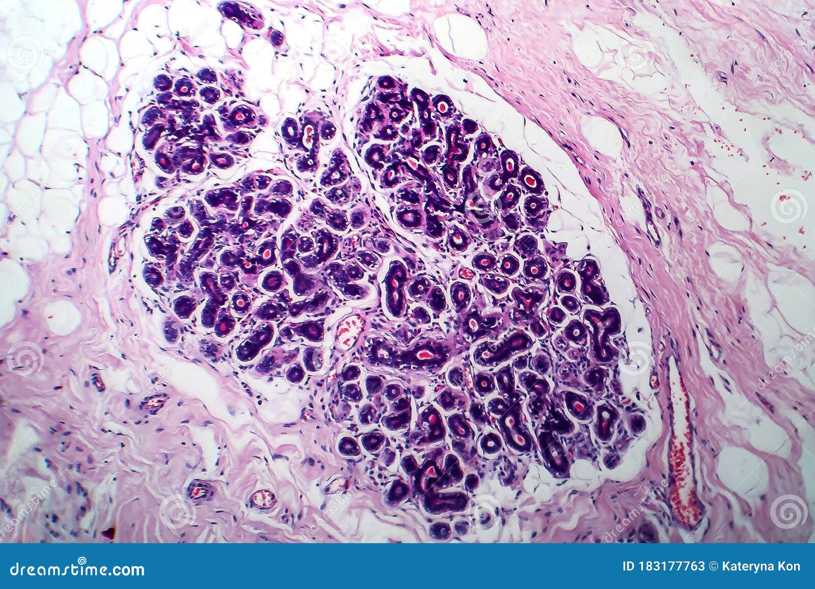 Microscopía De Luz Para Cáncer De Mama Imagen De Archivo Imagen De