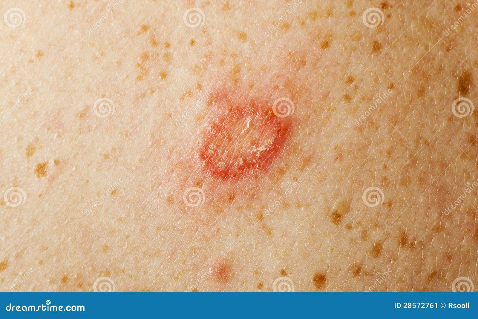 Microsporia A Fungus Stock Image - Image: 28572761