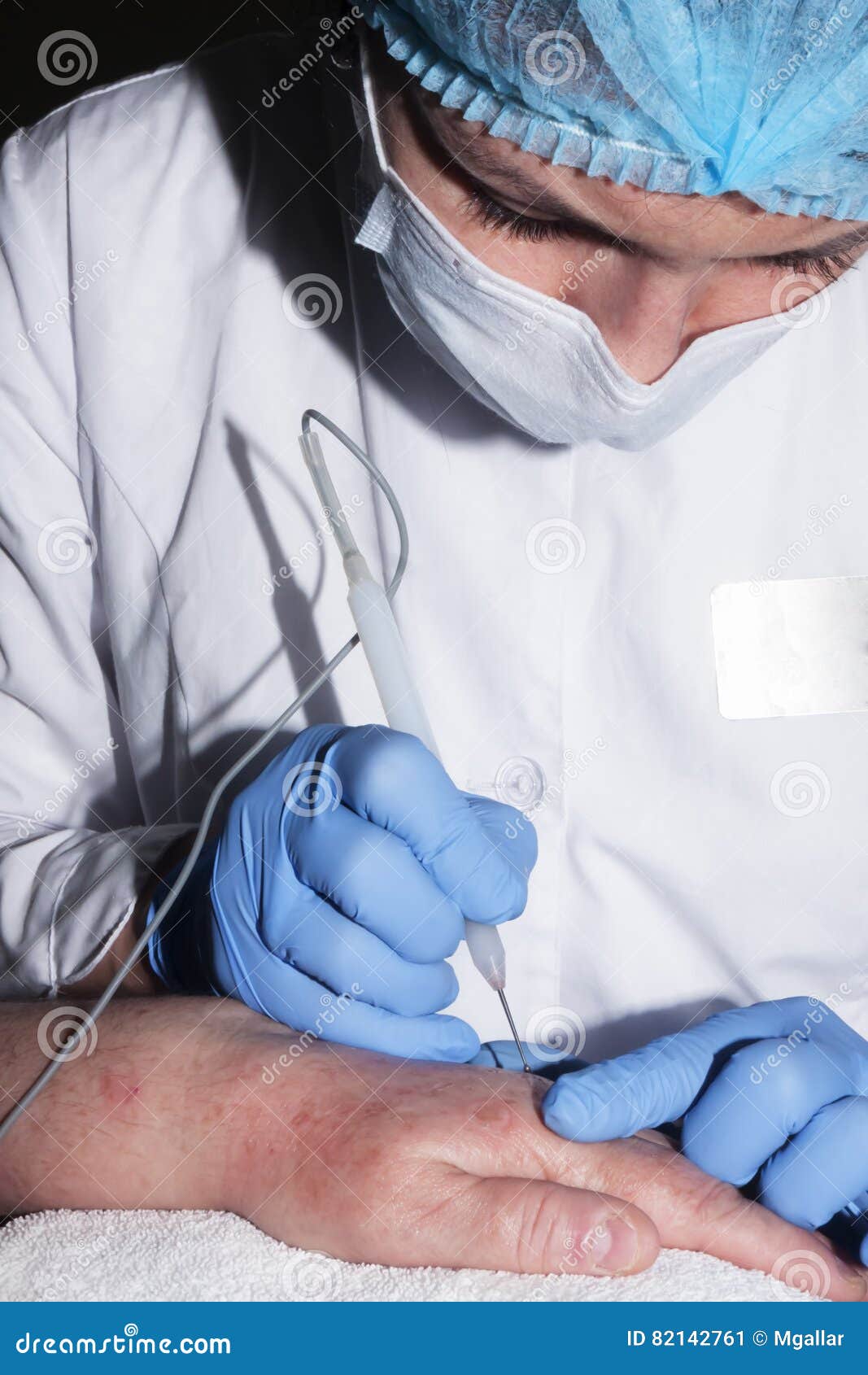 Microsurgery : Doctor Removes Skin Disease Stock Image - Image of ...