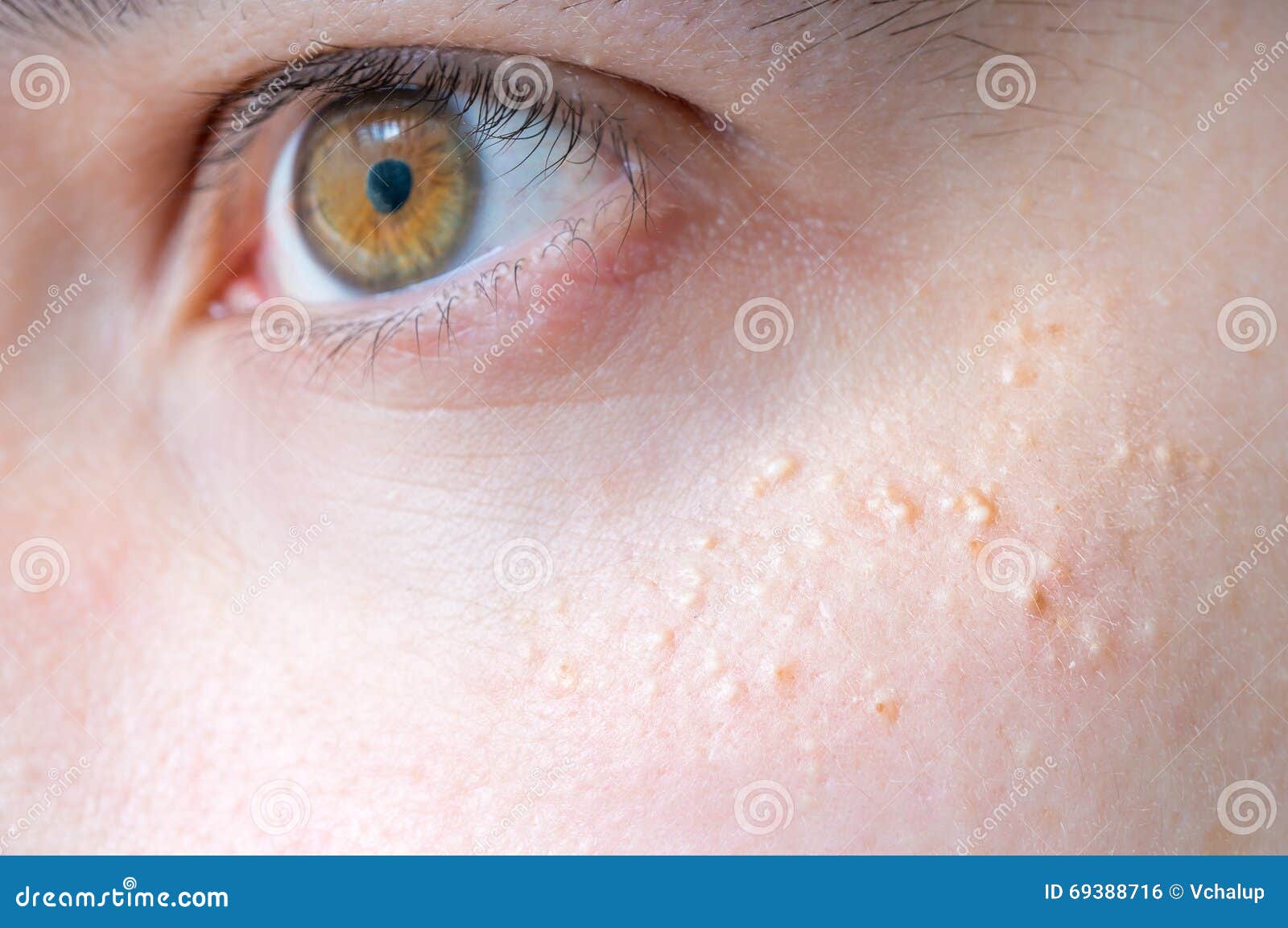 Milia Milium - Pimples Around Eye On Skin. Eyes Of Young Man With Small ...