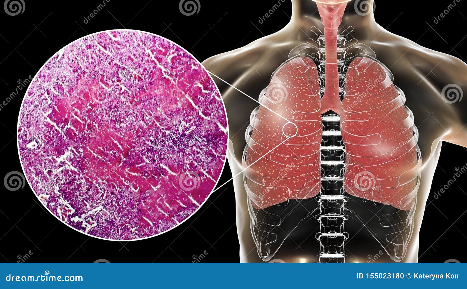 Miliary Tuberculosis, Illustration and Light Micrograph Stock ...
