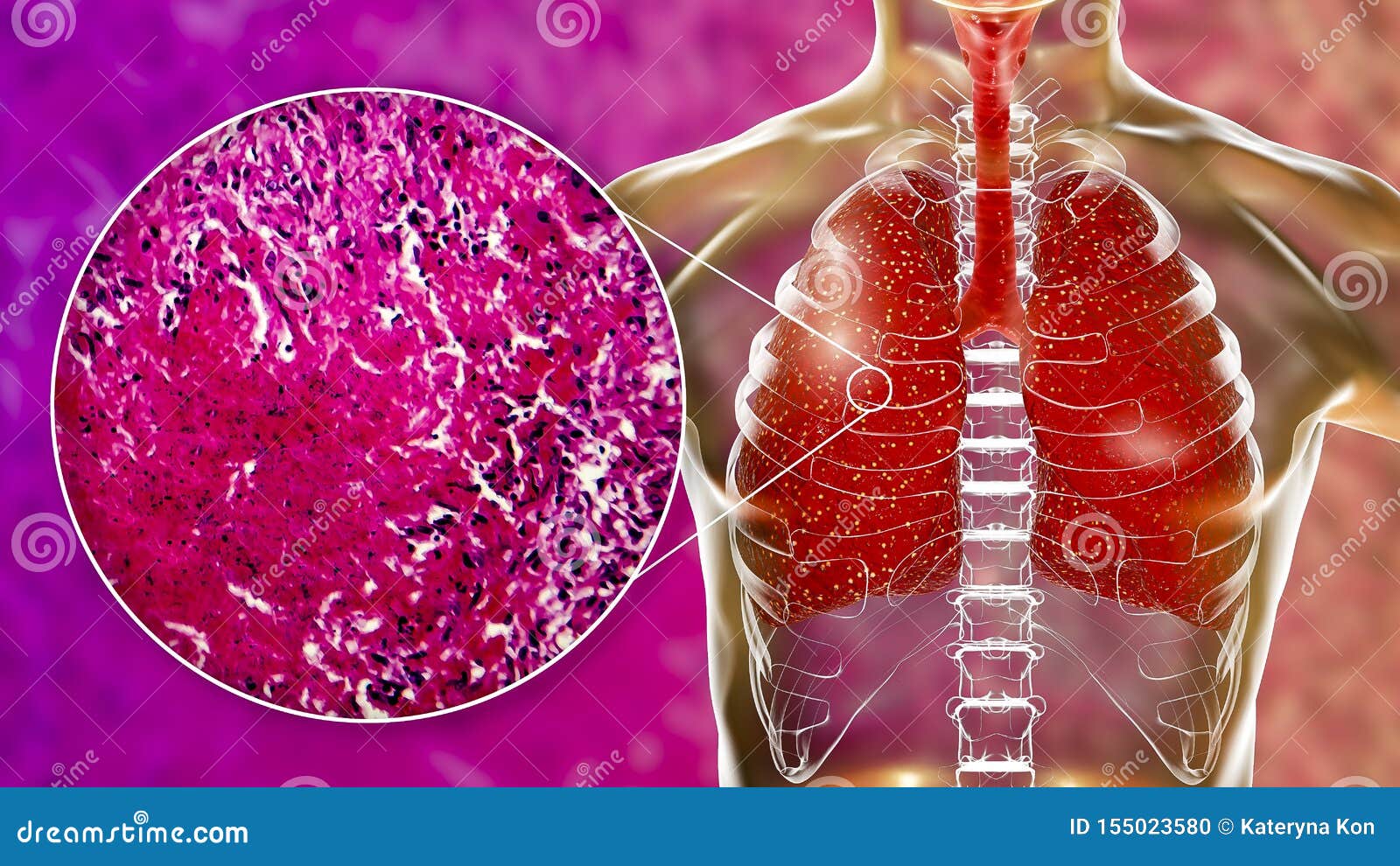 Miliary Tuberculosis, Illustration and Light Micrograph Stock ...
