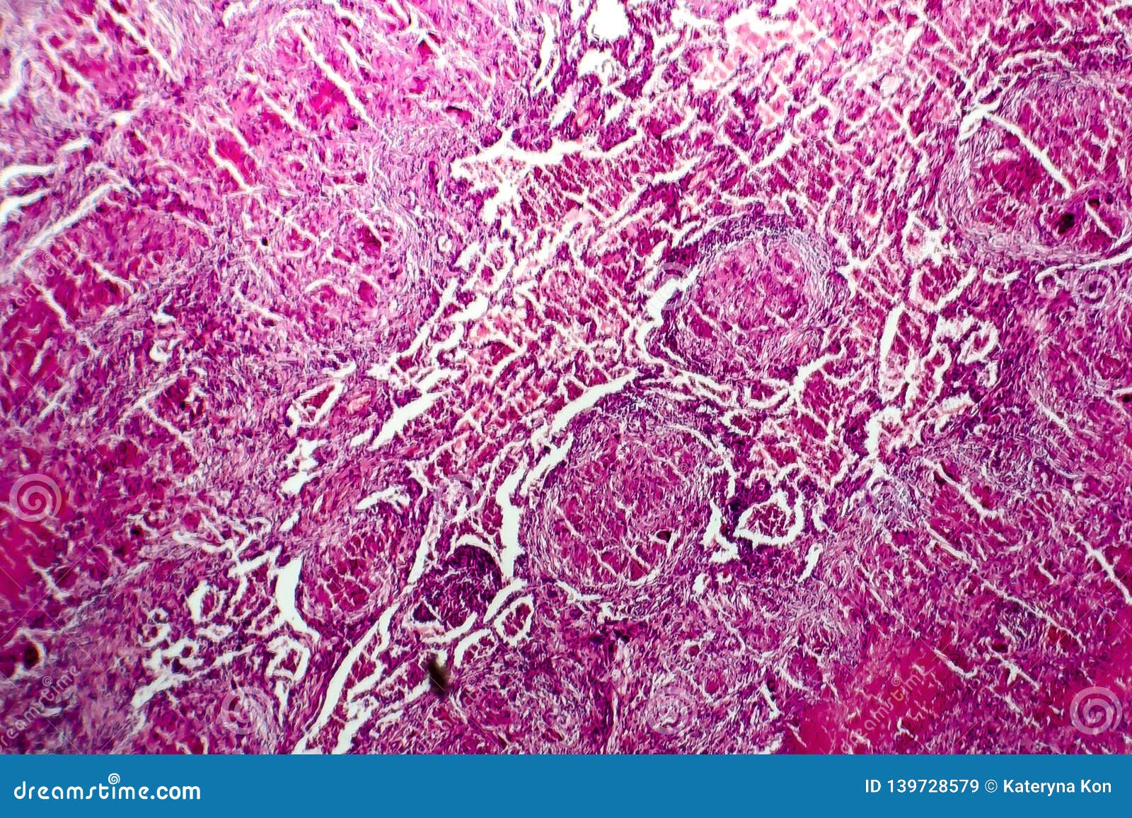 Miliary Tuberculosis, Light Micrograph Stock Image - Image of ...