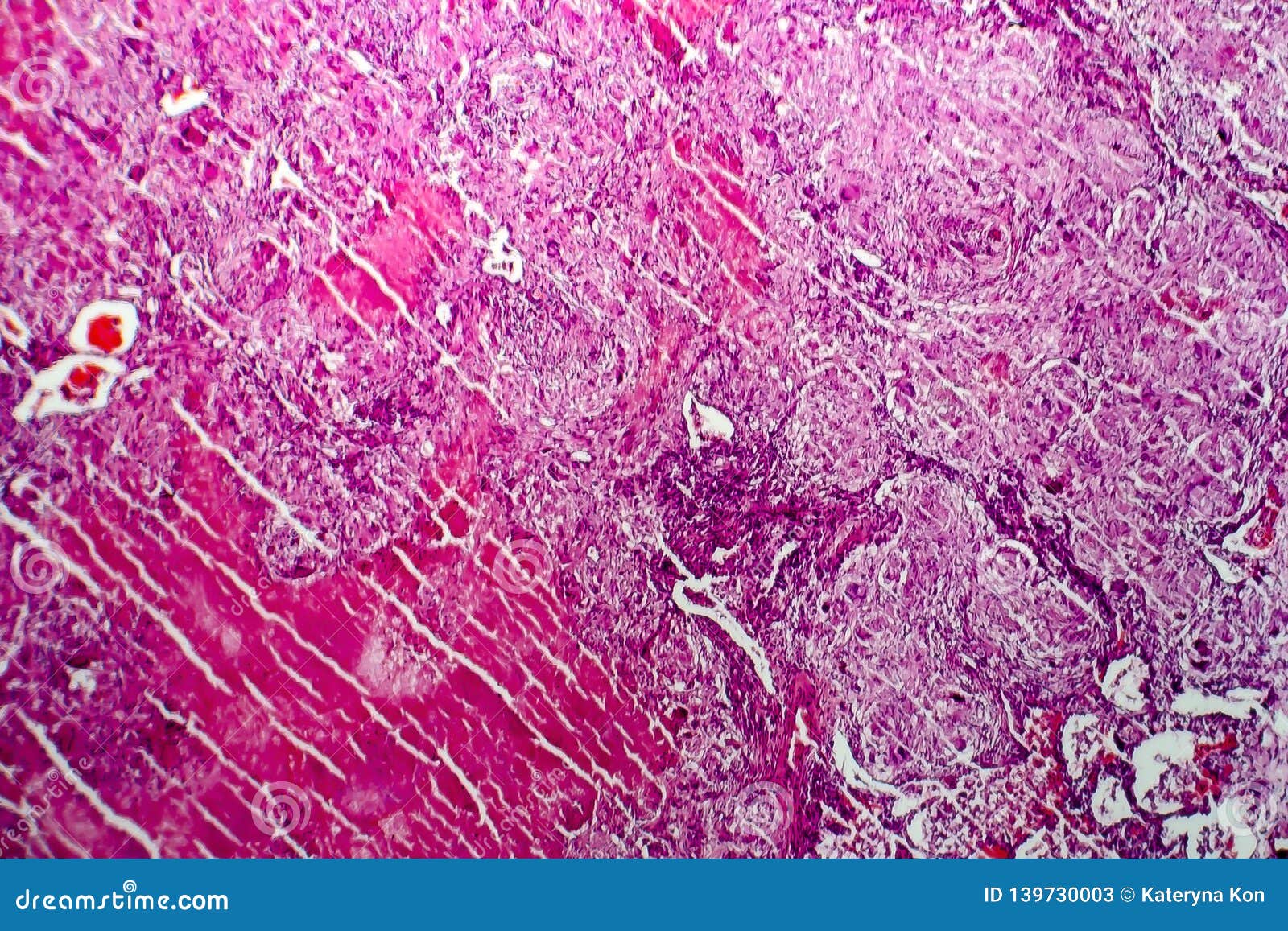 Miliary Tuberculosis, Light Micrograph Stock Image - Image of pathogen ...