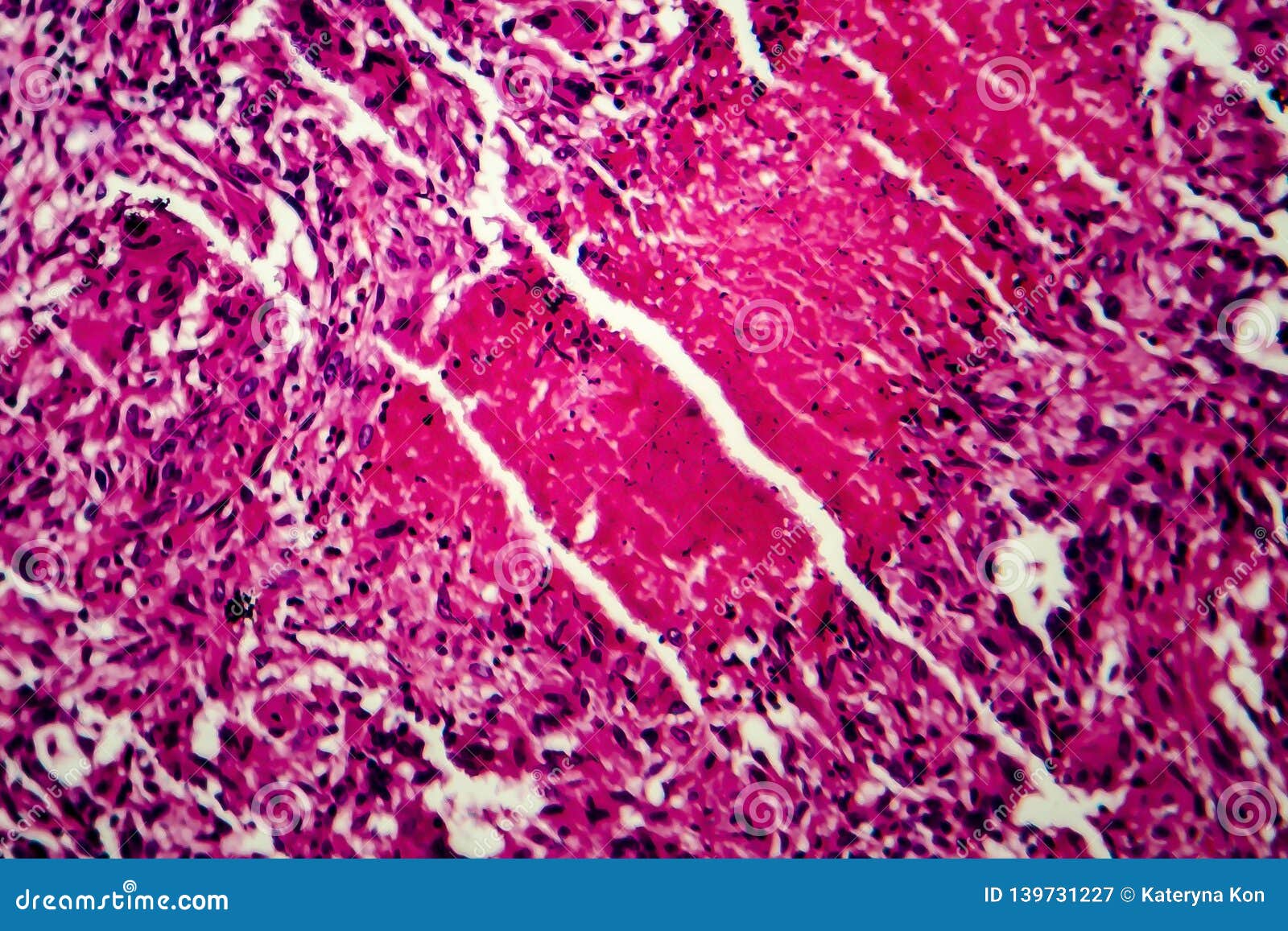 Miliary Tuberculosis, Light Micrograph Stock Image - Image of microbe ...